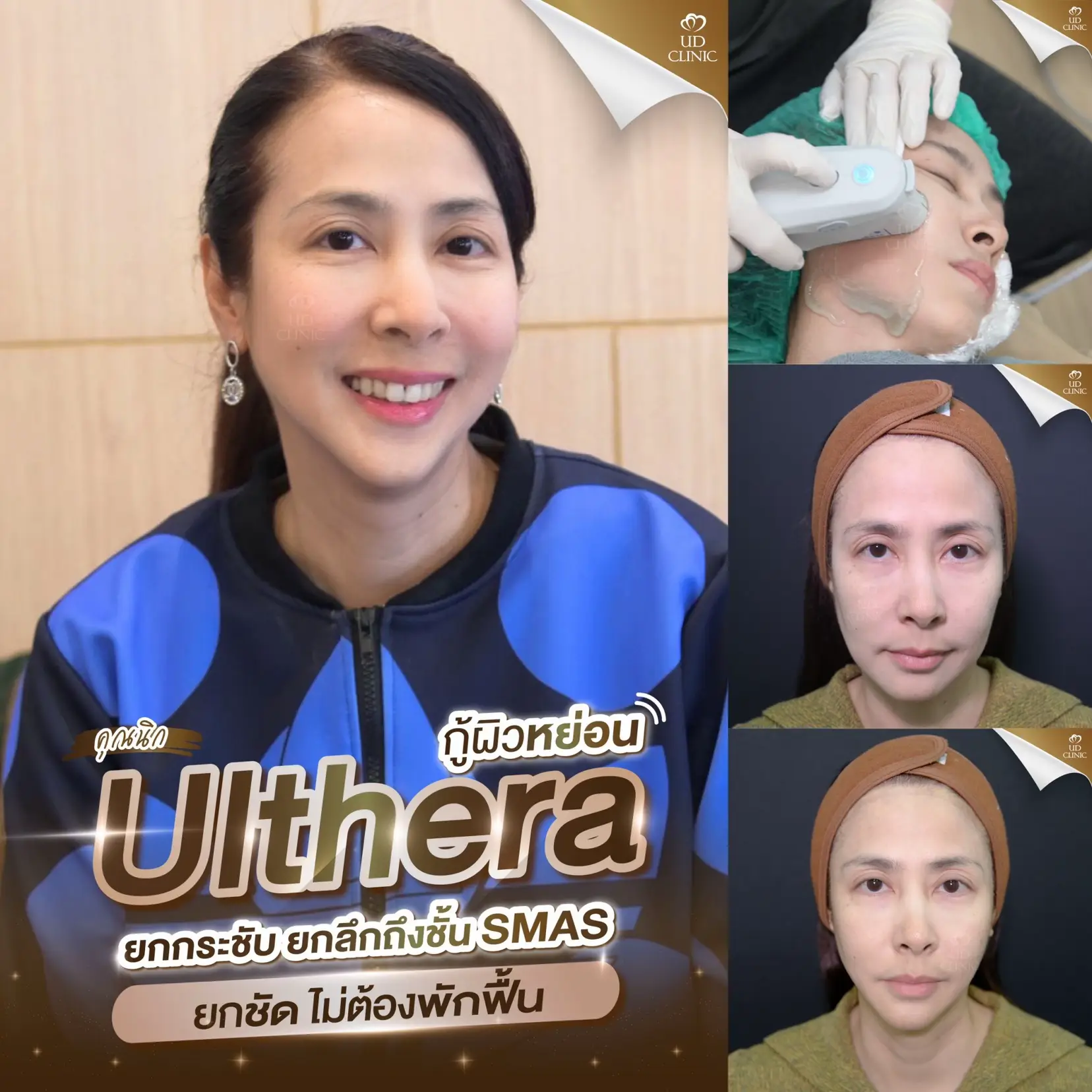 ULTHERA. Can the face really lift? | Gallery posted by UD Clinic | Lemon8