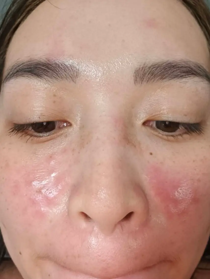 แชร์ประสบการณ์หน้าแพ้เครื่องสำอางแบบหนักสุด | แกลเลอรีที่โพสต์โดย Nutthawadee C | Lemon8