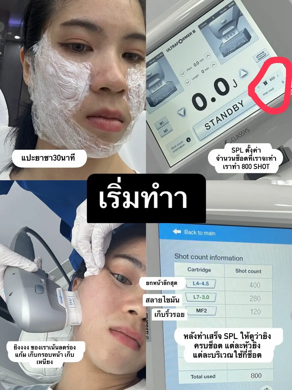 รีวิว Ultramax Hifu - การค้นหาใน Lemon8