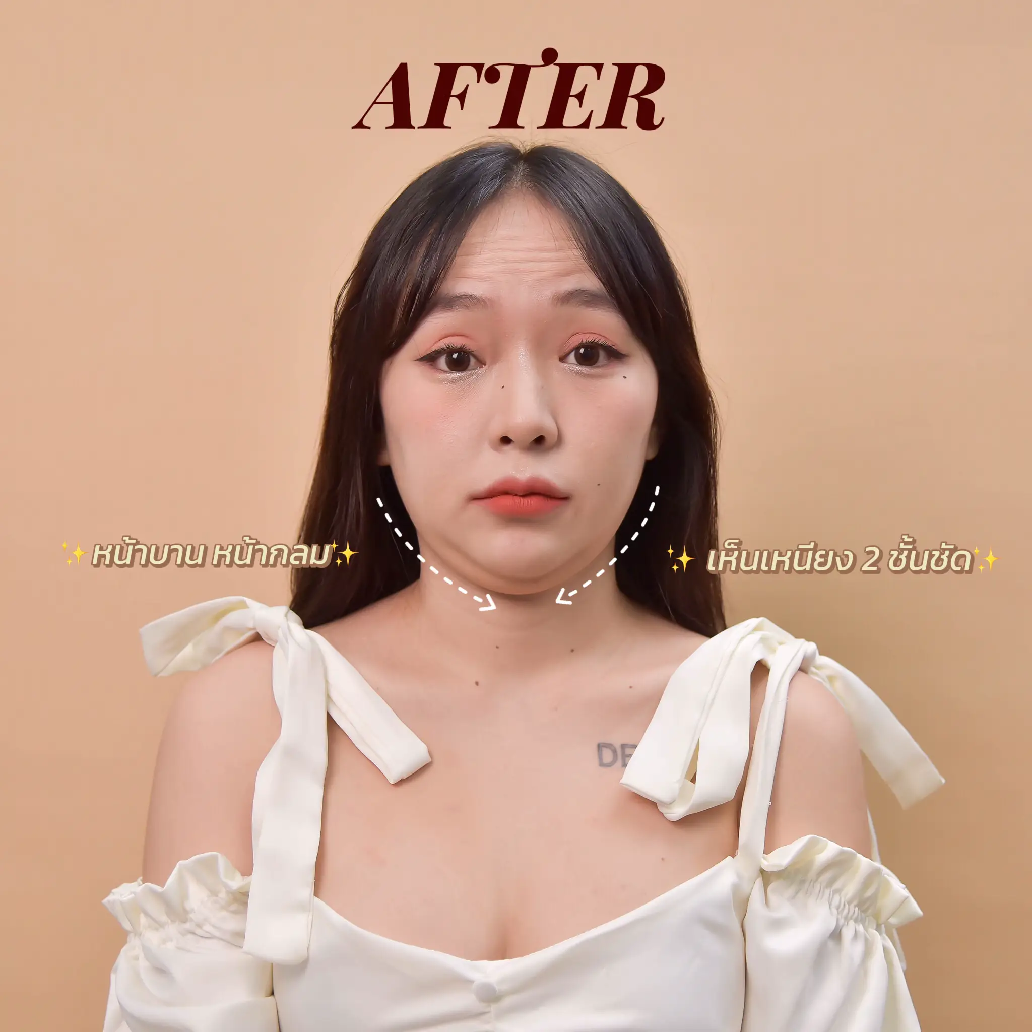 Botox กราม + Meso fat แก้ปัญหาหน้ากลมหน้าบาน!! | แกลเลอรีที่โพสต์โดย Dr.Karn Beauty | Lemon8