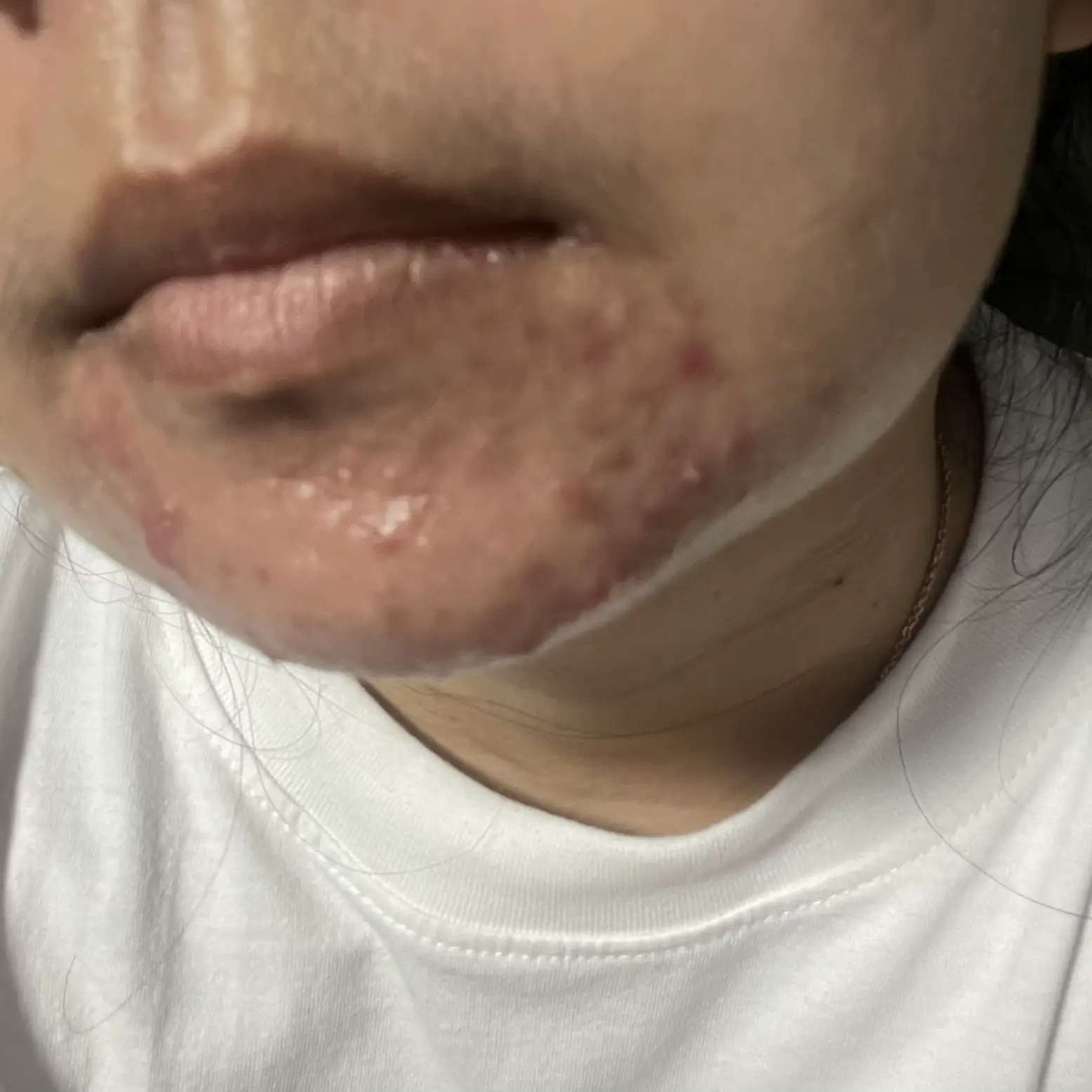 #ช่วยด้วยค่ะสิวแบบนี้รักษายังไงดี | แกลเลอรีที่โพสต์โดย phcrpn_beau ...