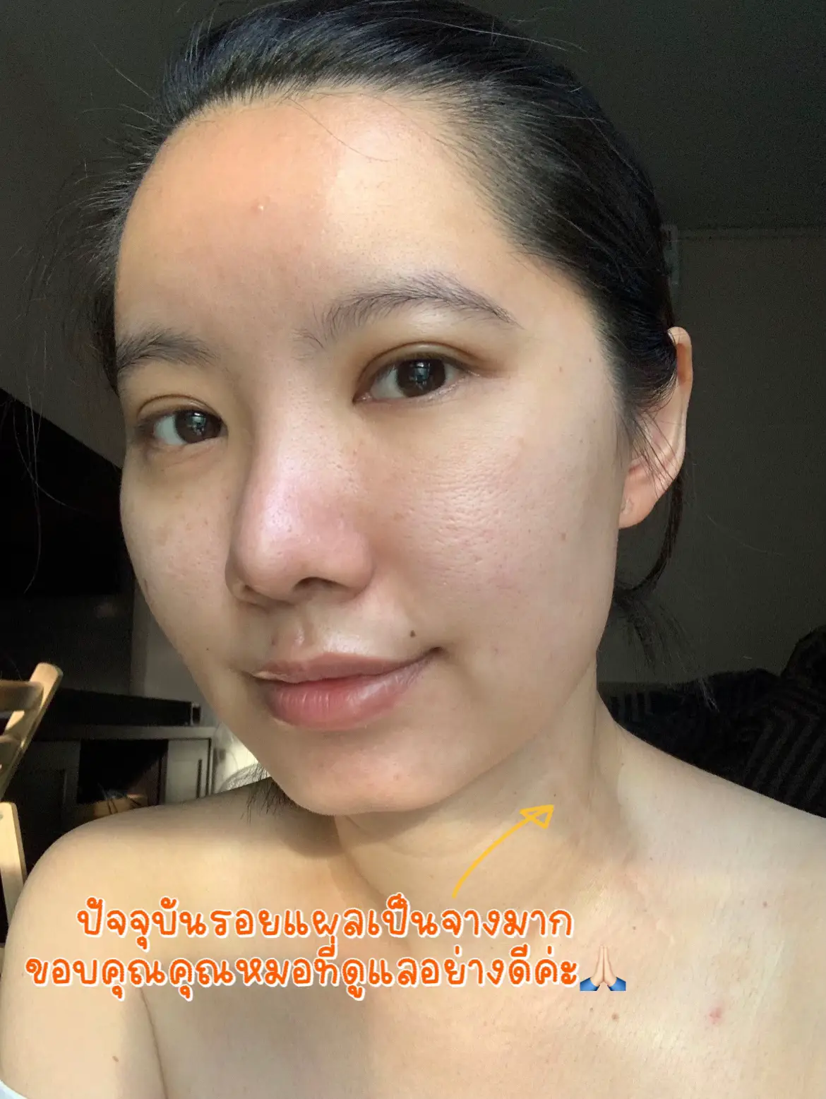 ประสบการณ์เป็นมะเร็งตอนอายุ 24 💪 | แกลเลอรีที่โพสต์โดย khuncha | Lemon8