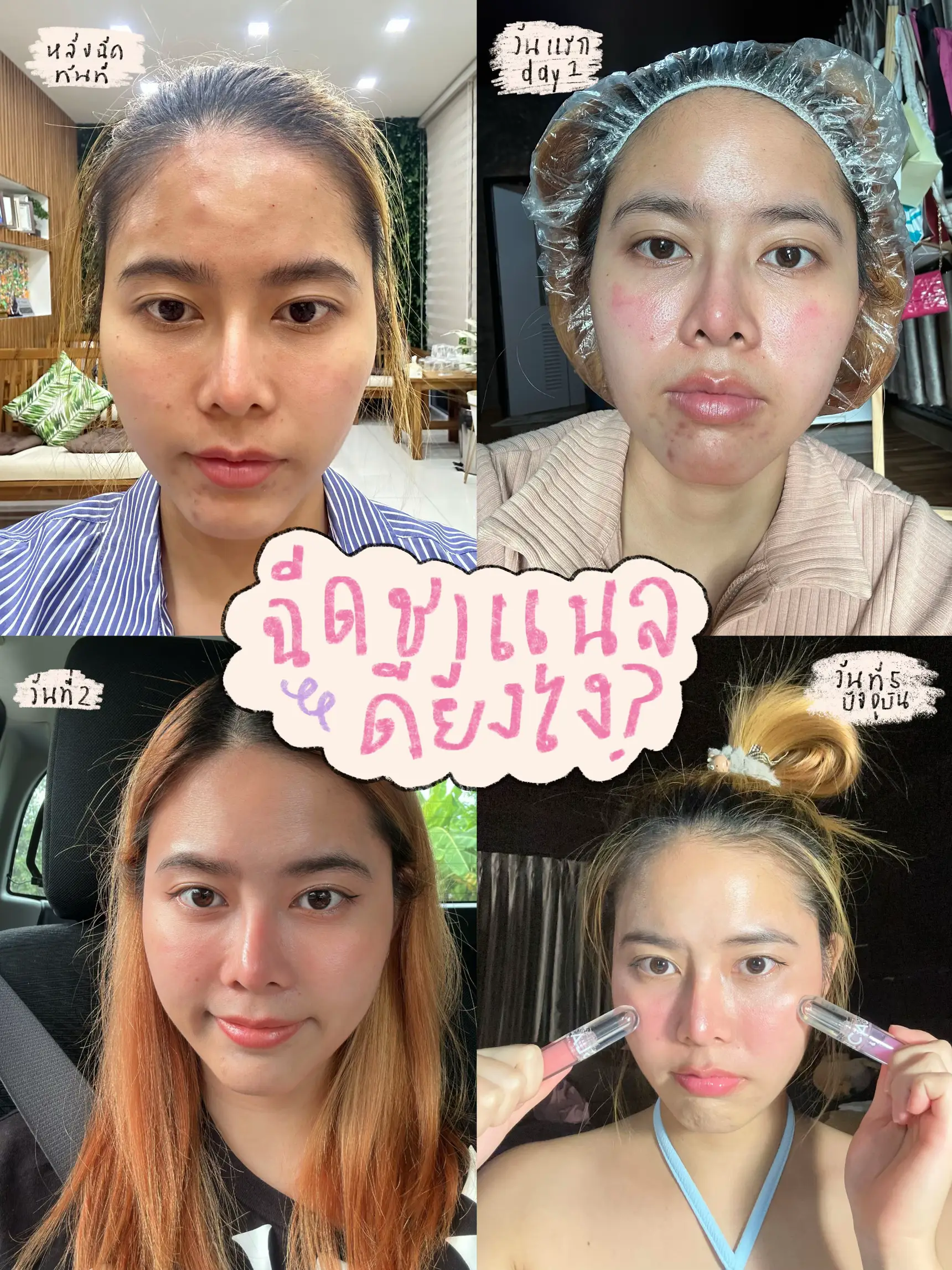 ฉีดชาแนลดียังไง ? ใครที่ต้องทำ ? ‼️🔥 | แกลเลอรีที่โพสต์โดย ssompns | Lemon8