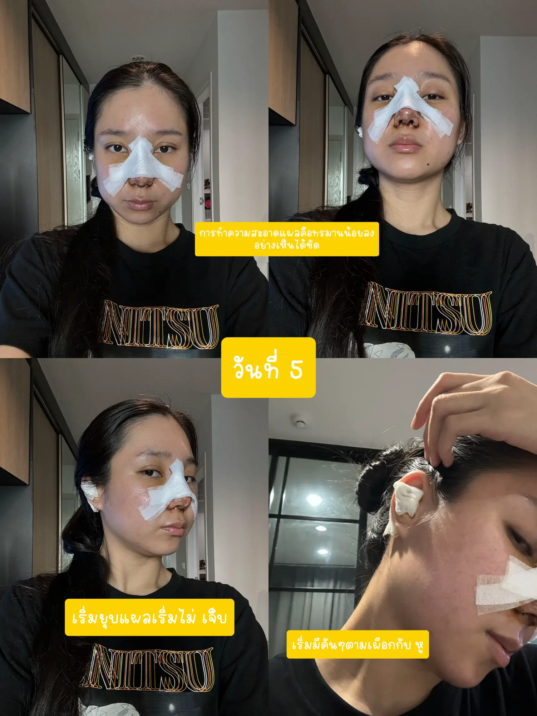 พรีชีพ ครั้งแรก เสริมจมูก full open+กระดูกหลังหู no spon | แกลเลอรีที่ ...