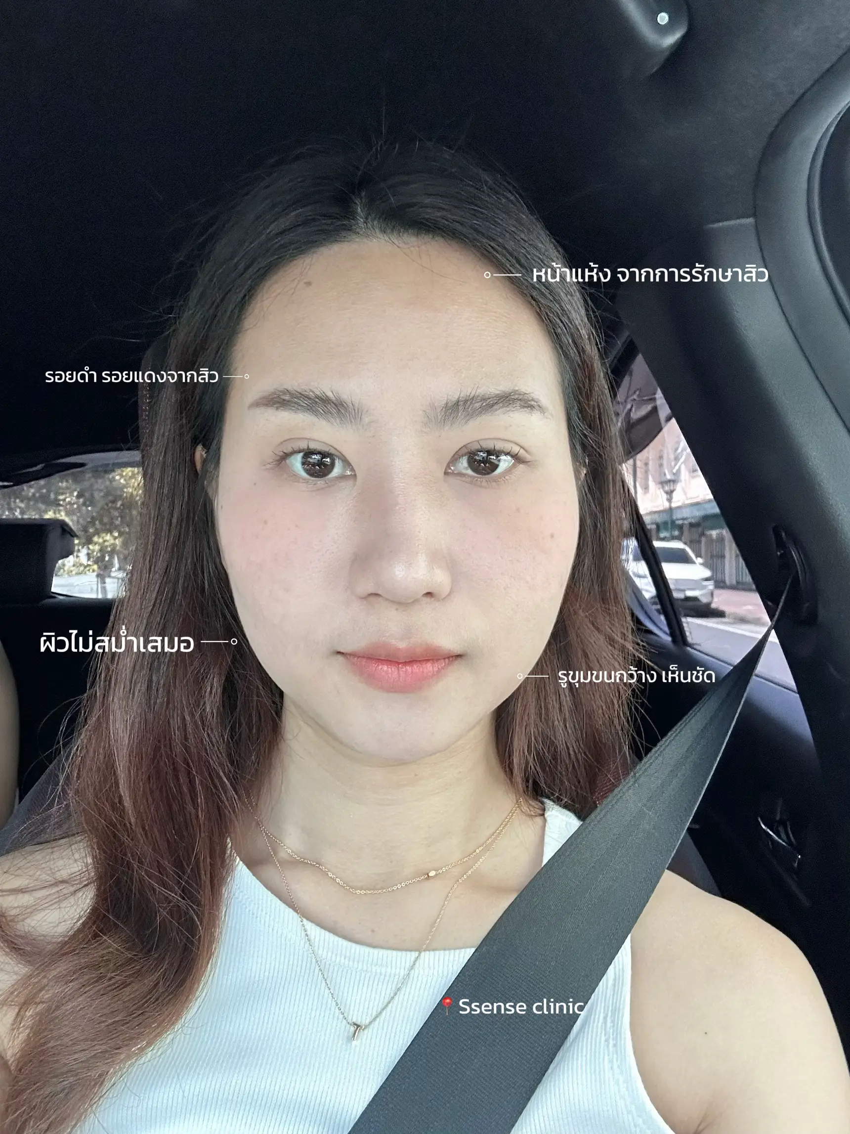 แชร์ประสบการณ์💉 ฉีดหน้าฉ่ำโกลว์ เห็นผลเร็วมาก | แกลเลอรีที่โพสต์โดย Bai por | Lemon8