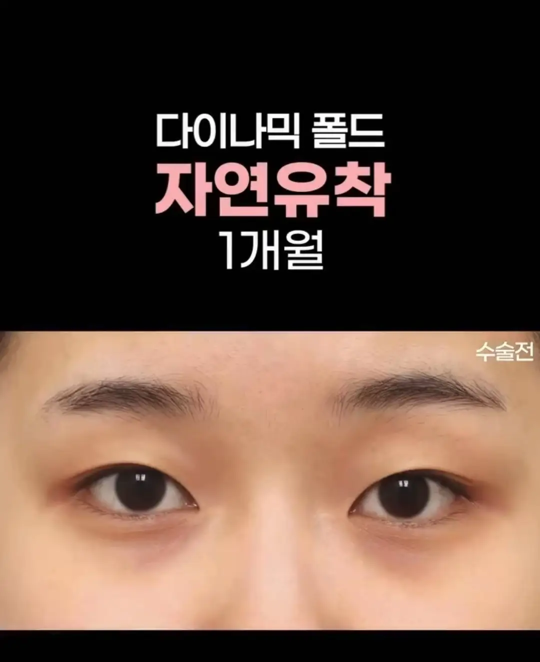 Natural eyelid surgery. Before&after. | วิดีโอที่เผยแพร่โดย Jsisters.th ...