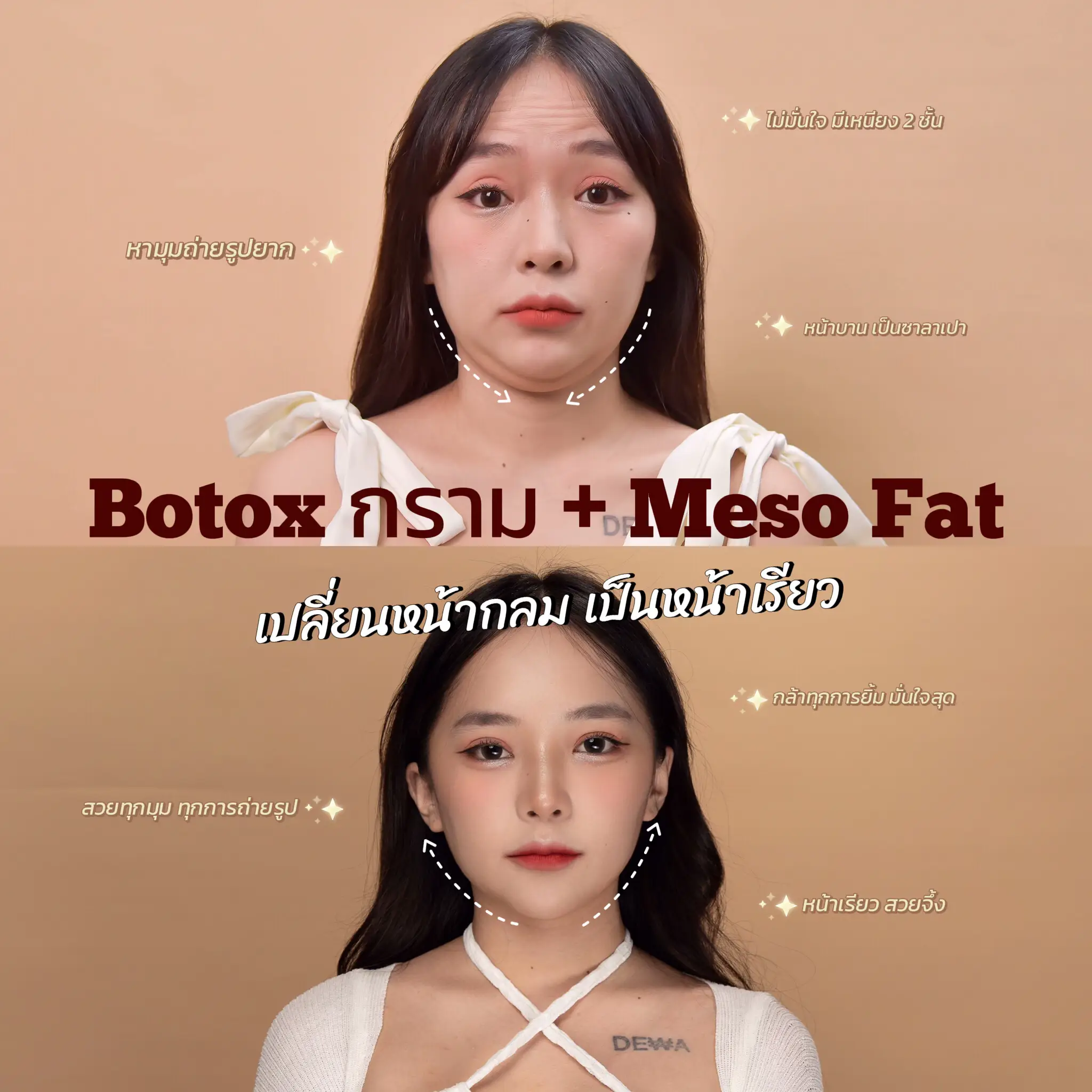 Botox กราม + Meso fat แก้ปัญหาหน้ากลมหน้าบาน!! | แกลเลอรีที่โพสต์โดย Dr.Karn Beauty | Lemon8