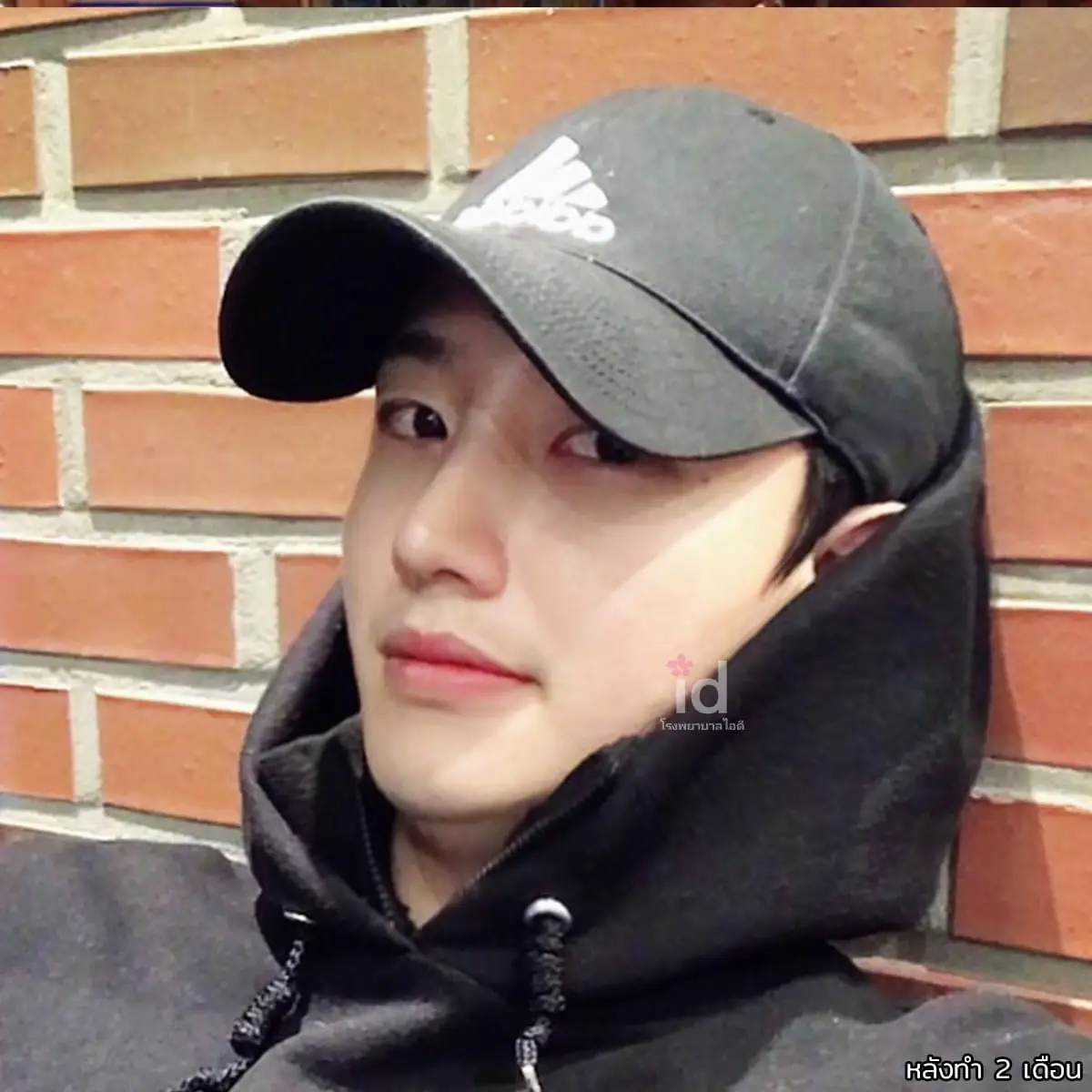 ศัลยกรรมผู้ชาย | แกลเลอรีที่โพสต์โดย Noom BTF | Lemon8