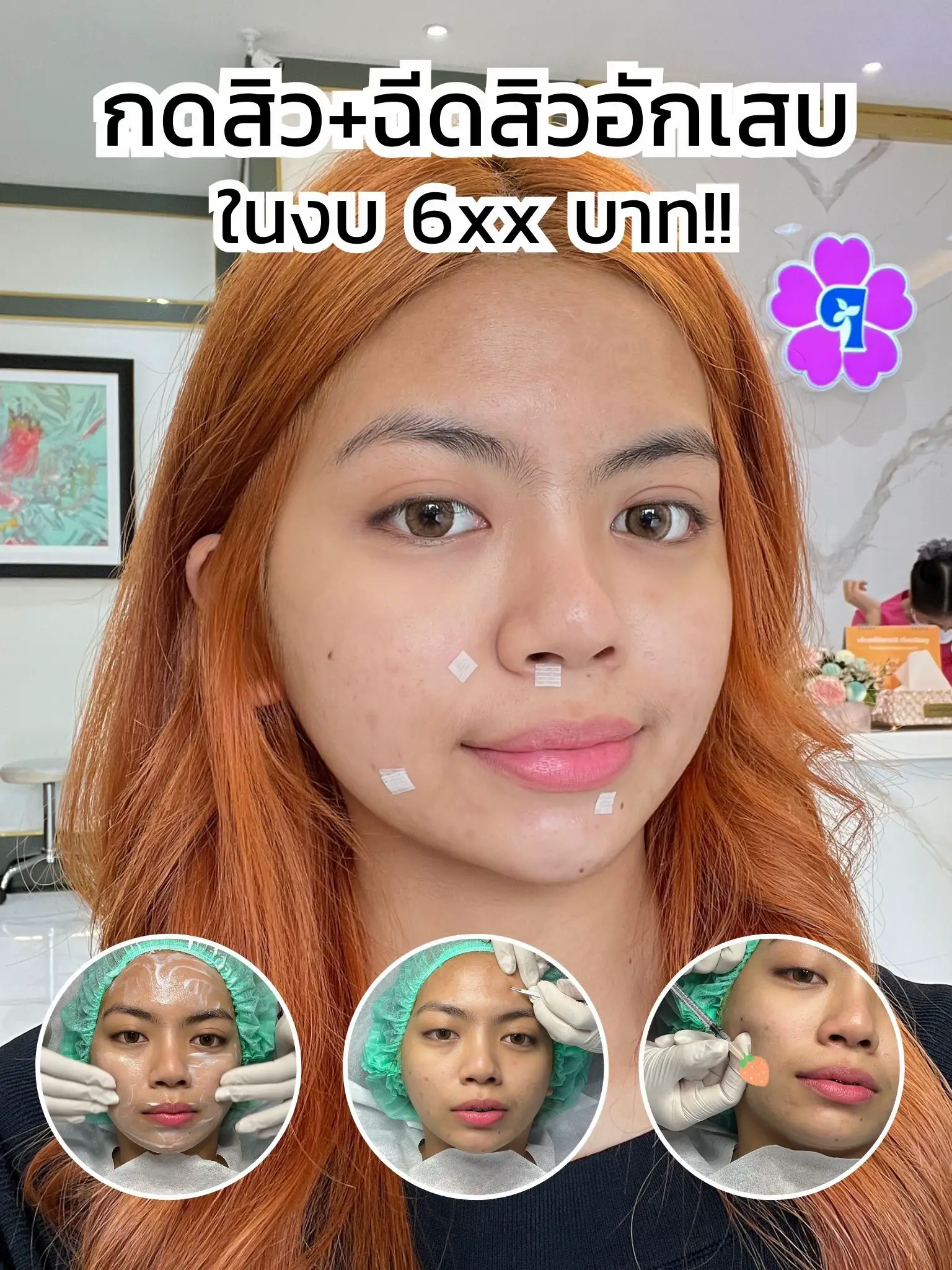 กดสิว+ฉีดสิวอักเสบในราคา 6xx.- | ใครสิวเยอะต้องมากด่วน!! | แกลเลอรีที่ ...