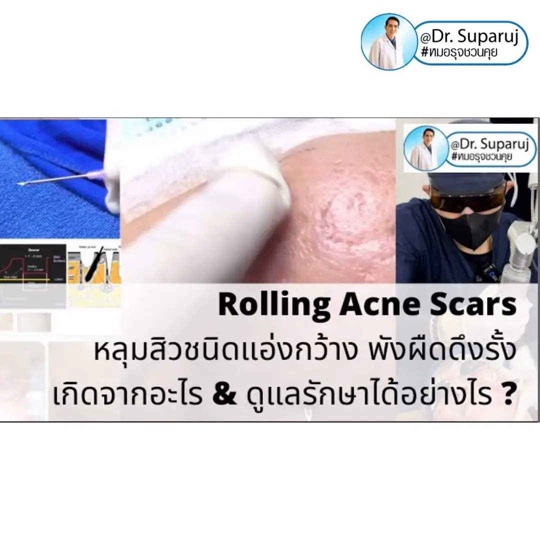 Rolling Acne Scars หลุมสิวชนิดแอ่งกว้าง เกิดจากอะไร ? | แกลเลอรีที่ ...