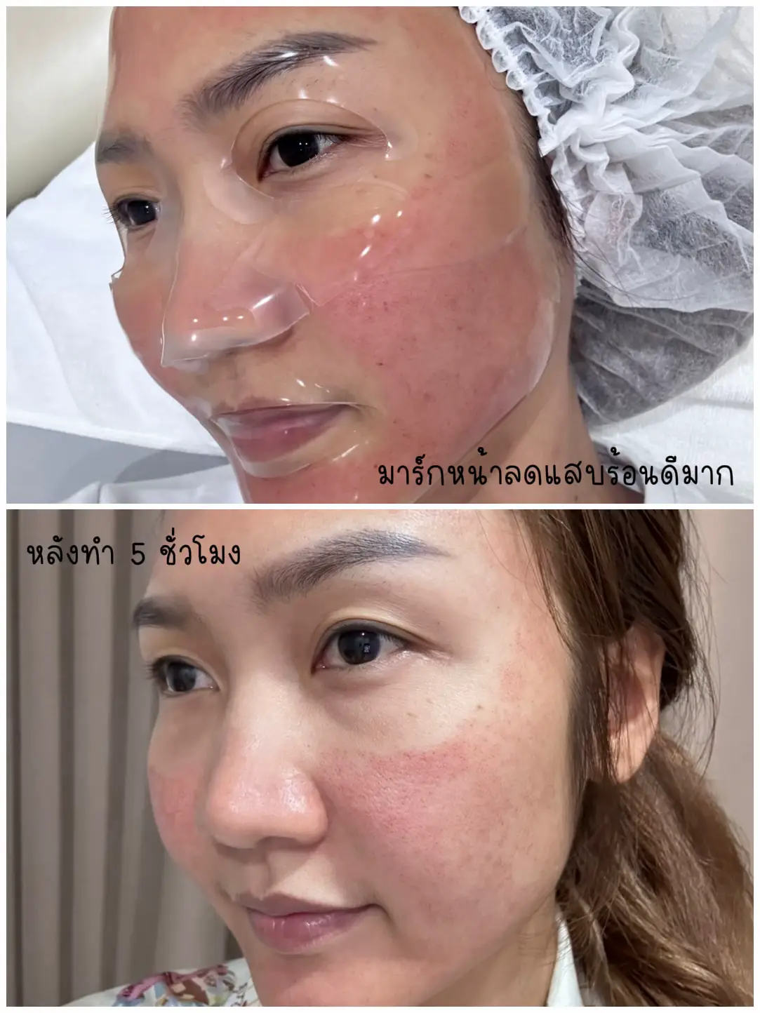 Pico Laser ครั้งที่ 3 แล้ว 😎 ดูแลผิวยังไงบ้าง | แกลเลอรีที่โพสต์โดย ...