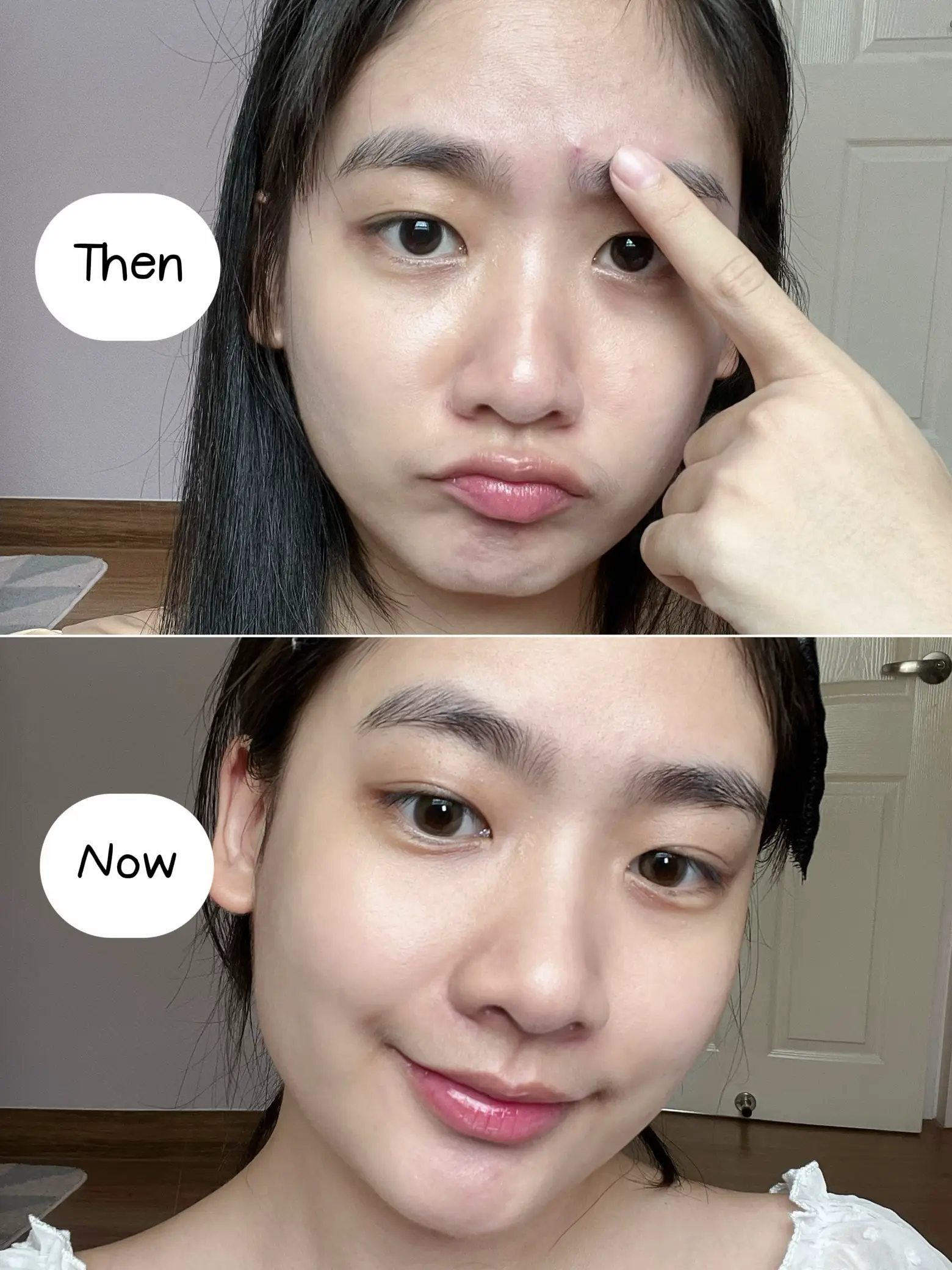 แชร์ประสบการณ์ฝั่งเข็มครั้งแรก | แกลเลอรีที่โพสต์โดย Something_like | Lemon8