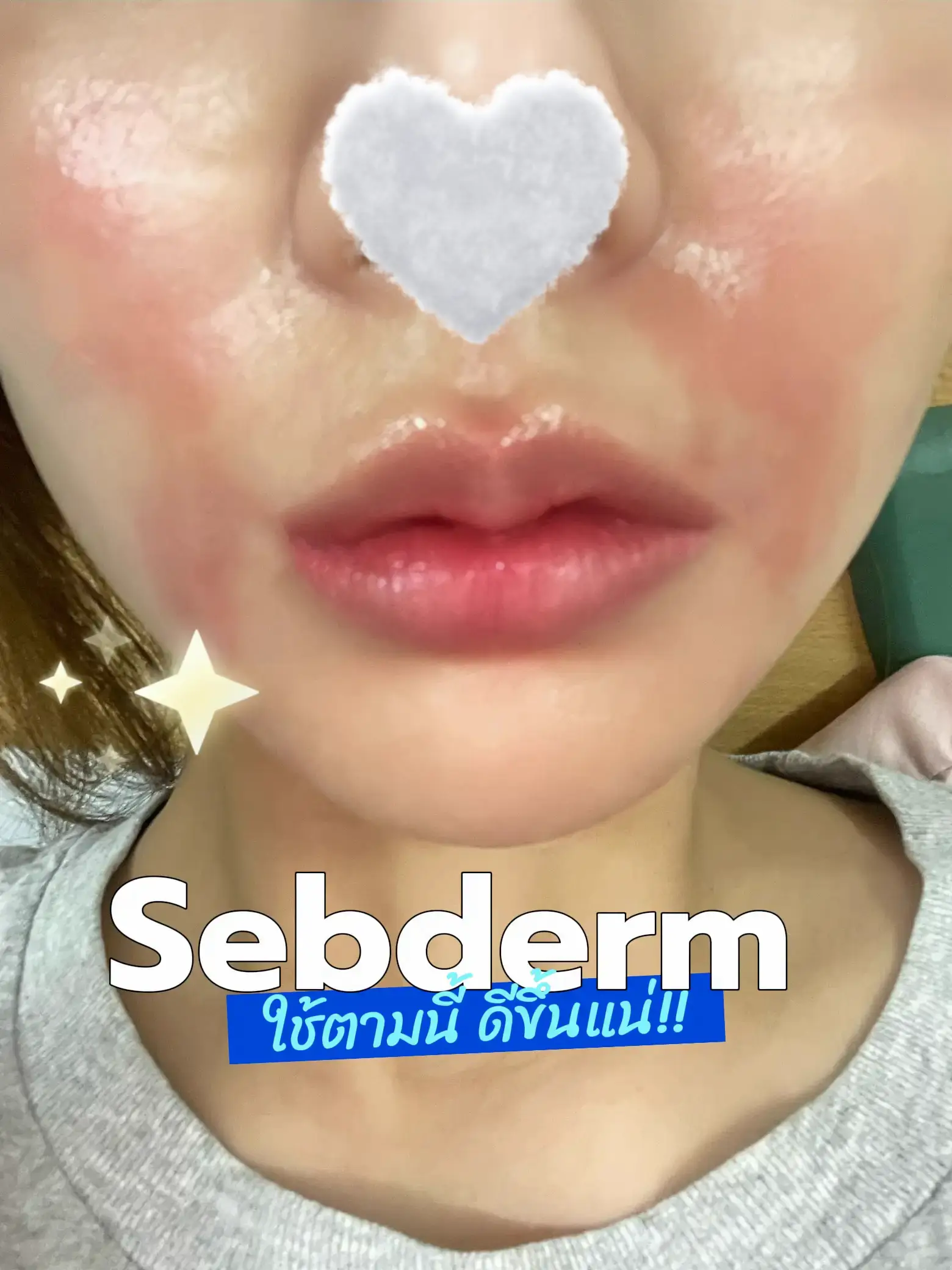 Sebderm 🧖🏻‍♀️🦠 | แกลเลอรีที่โพสต์โดย Fonxpnck🌦️ | Lemon8