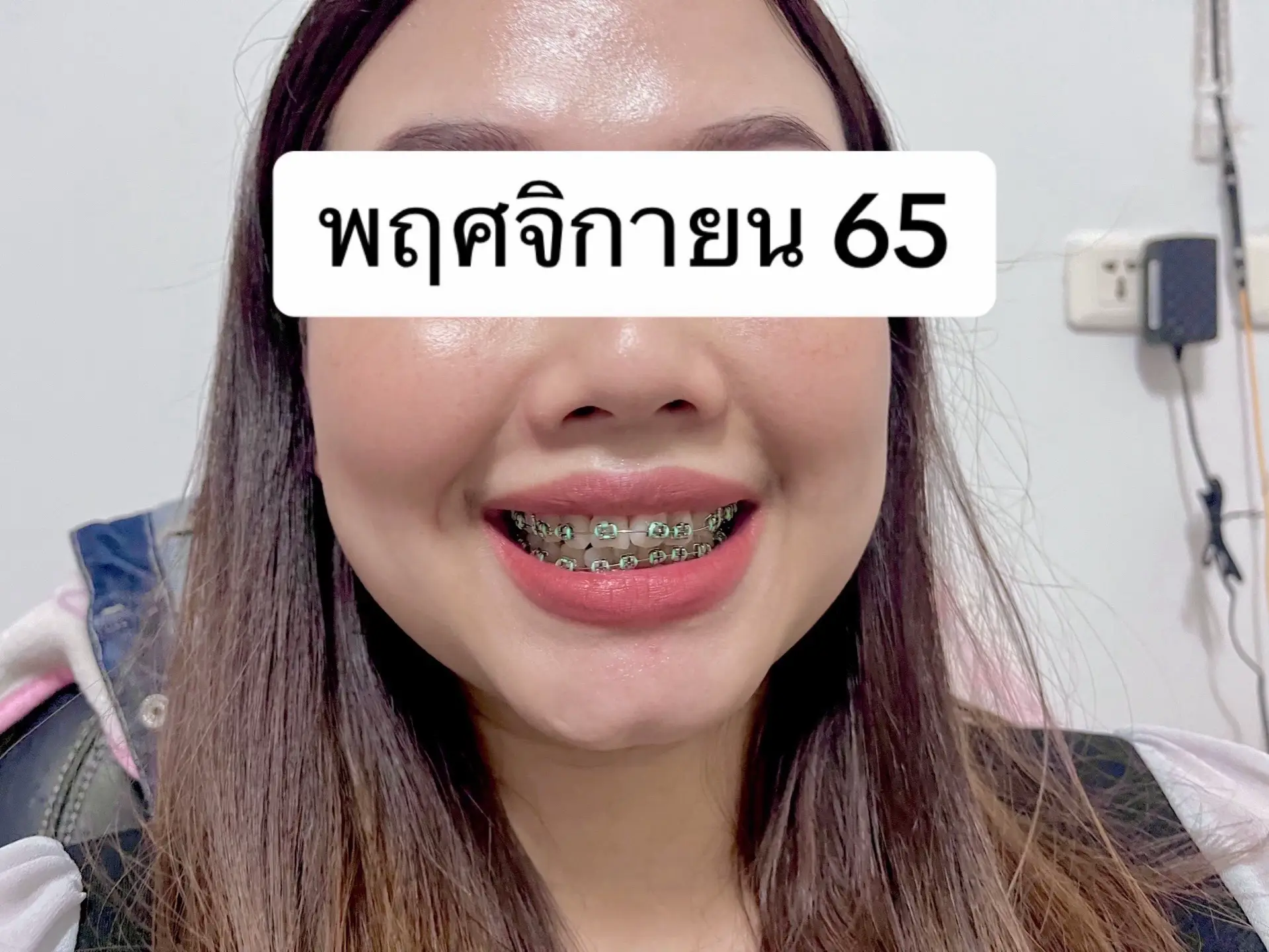 รีวิวจัดฟัน @ศาลายา นครปฐม | แกลเลอรีที่โพสต์โดย Thitikarn Boo | Lemon8