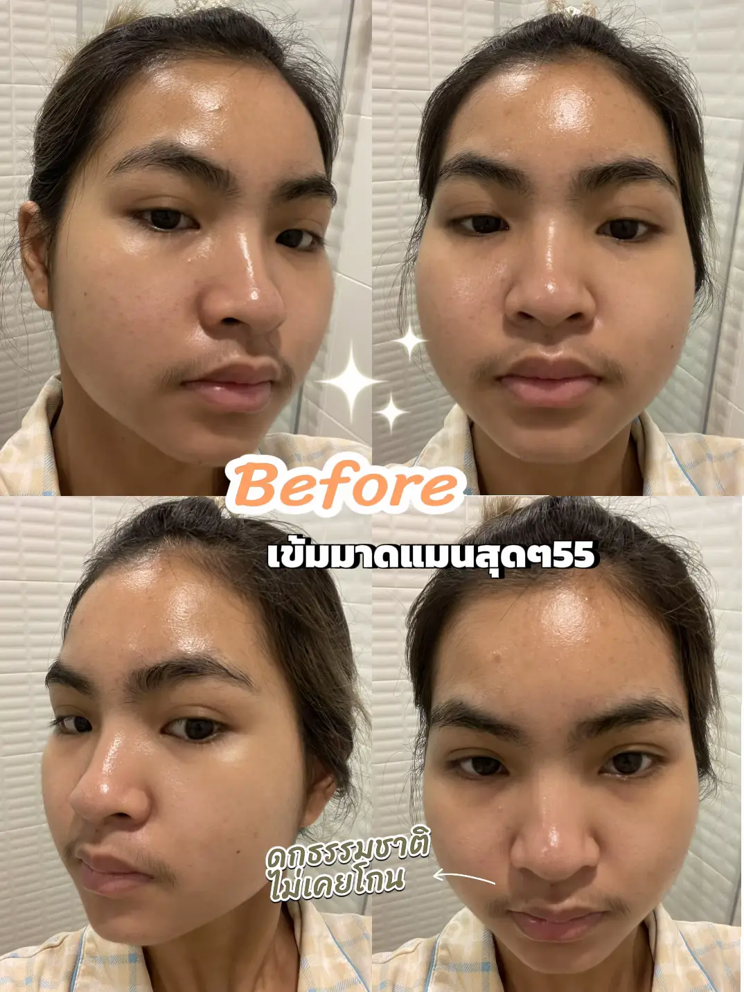 เลเซอร์ขน เวอร์ชั่นสาวมีหนวดดด🧔‍♀️ ️ | แกลเลอรีที่โพสต์โดย Berbbu.beb | Lemon8