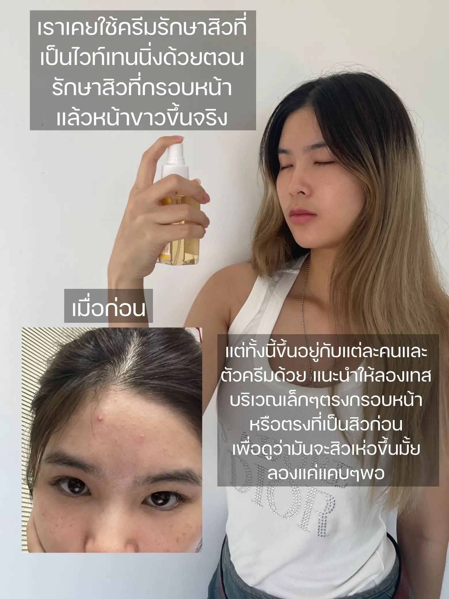 คนเป็นสิว ห้ามทาไวท์เทนนิ่งจริงมั้ย?😖| ทาแล้วจะสิวเห่อมั้ย? | แกลเลอรี ...