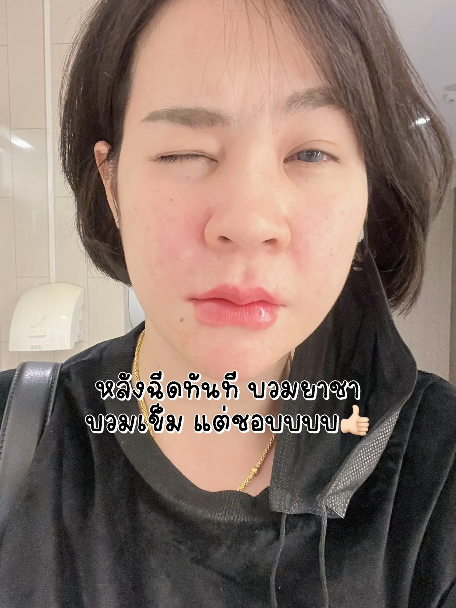 มือใหม่ฉีดฟิลเลอร์ครั้งแรก ขอ1 ซีซีก่อนค่ะหมอ | แกลเลอรีที่โพสต์โดย Ma riam | Lemon8