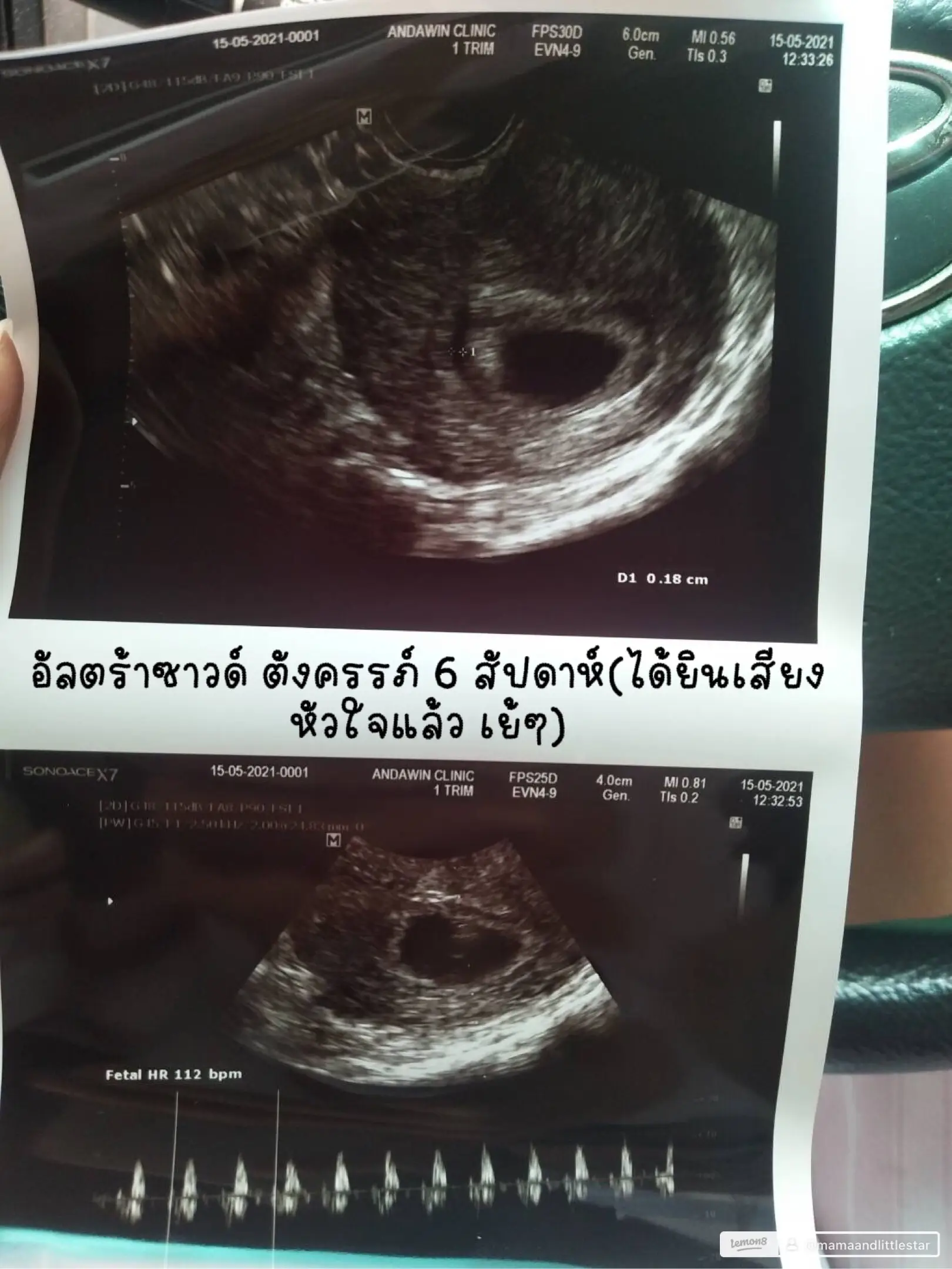 ท้องธรรมชาติ ด้วยยากระตุ้นไข่ | แกลเลอรีที่โพสต์โดย แม่ไม่ไปทำงาน | Lemon8