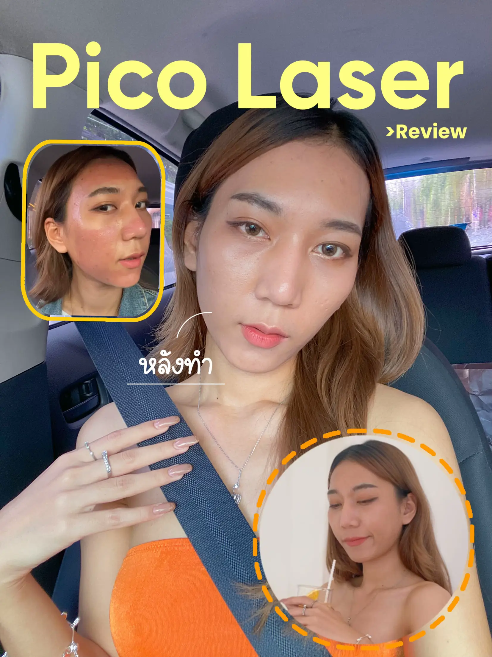 Review Pico Laser จุดด่างดำ รอยสิว หลุมสิว รูขุมขนกว้าง | แกลเลอรีที่โพสต์โดย REVIEW😻 | Lemon8