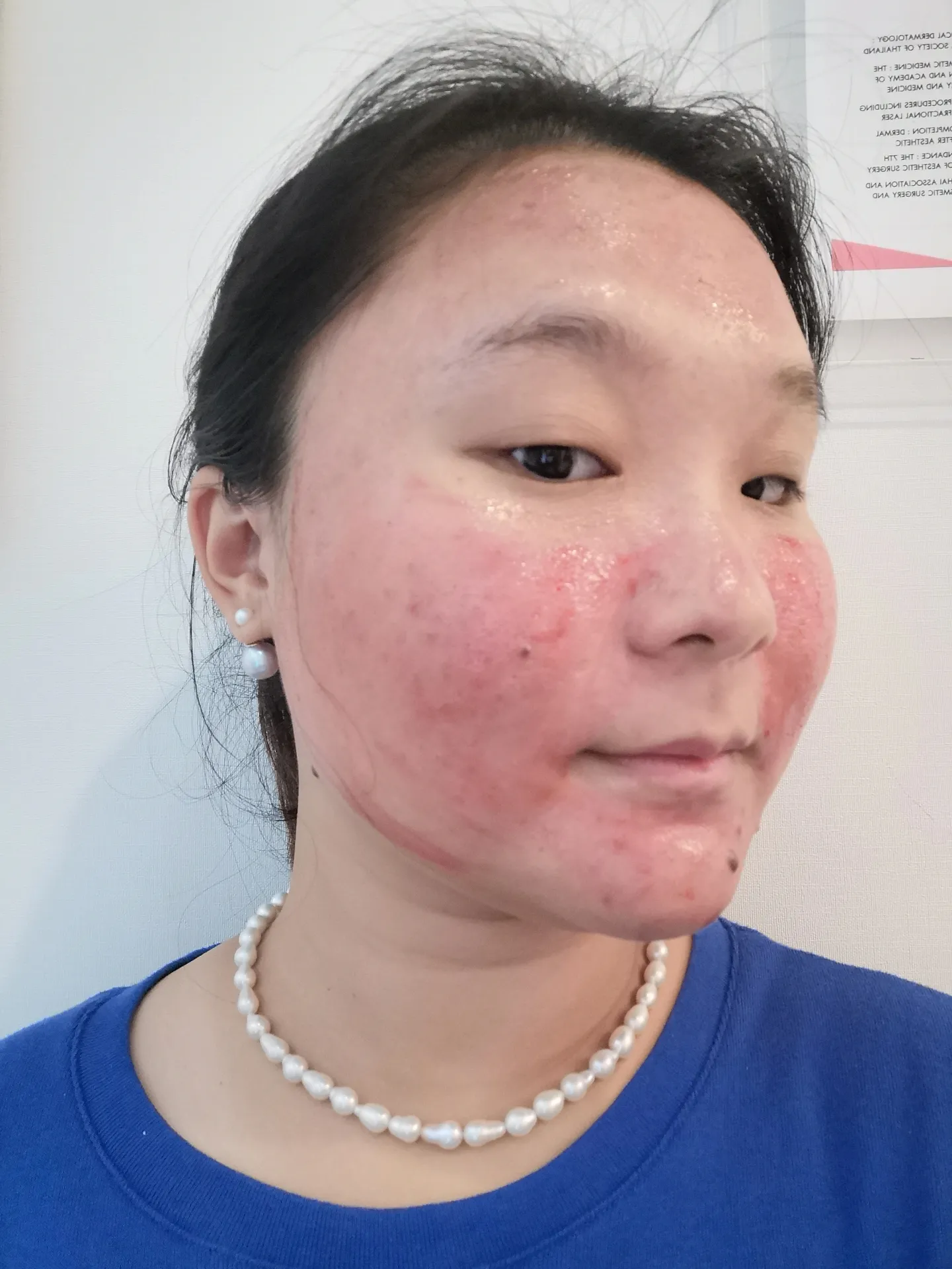 รีวิวประสบการณ์ รักษาหลุมสิวที่เป็นมา 6 ปี💢💥 | แกลเลอรีที่โพสต์โดย Dr ...