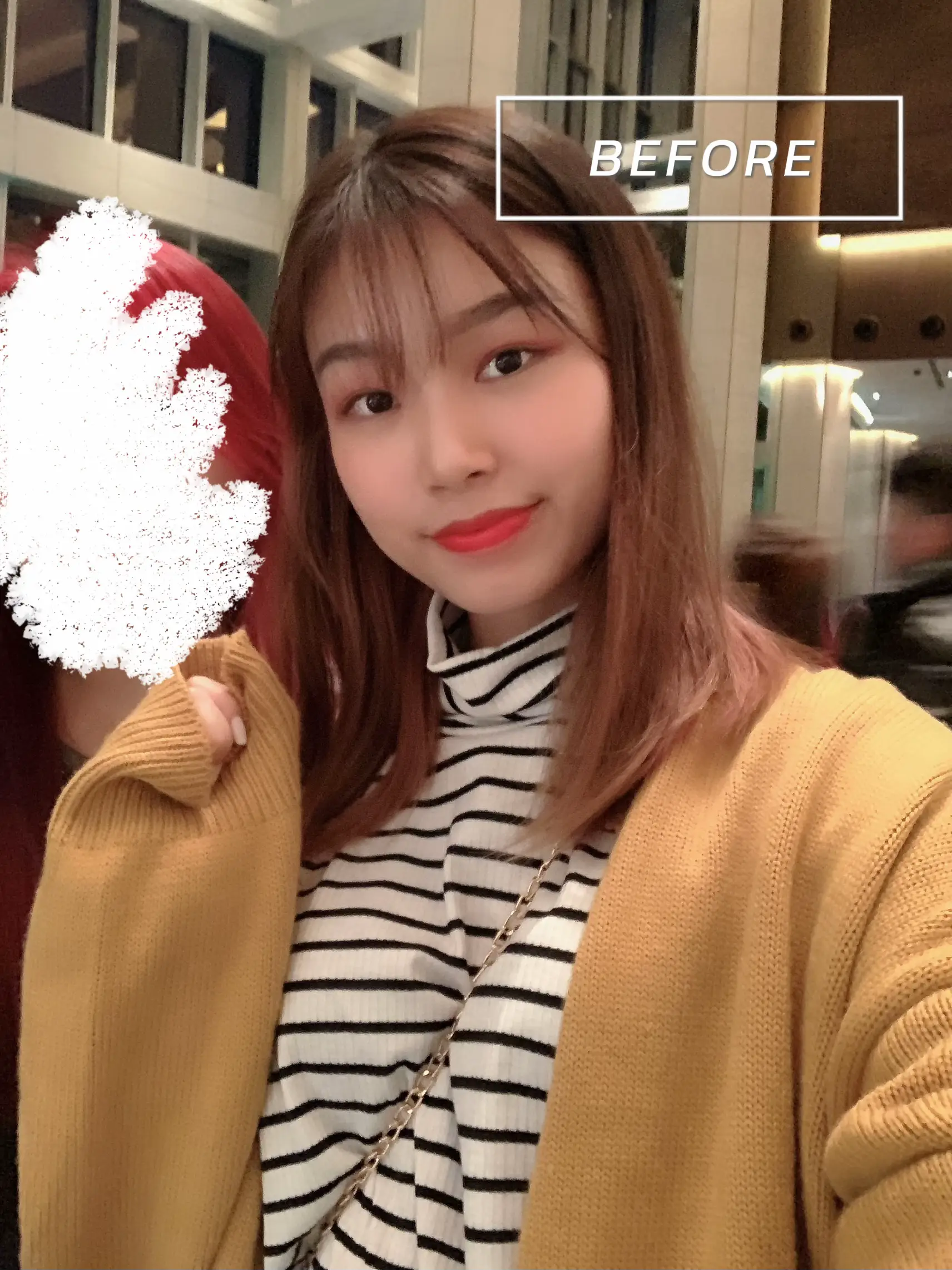 My first filler experience back in 2019 ☝🏻 | Gallery posted by ...