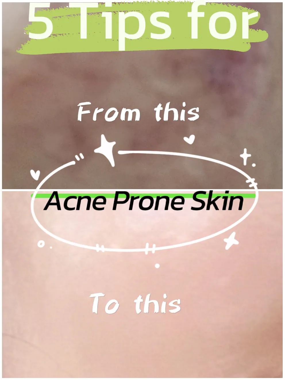 5 Tips for Acne Prone Skin | Galeri disiarkan oleh Luna Aesthetica | Lemon8