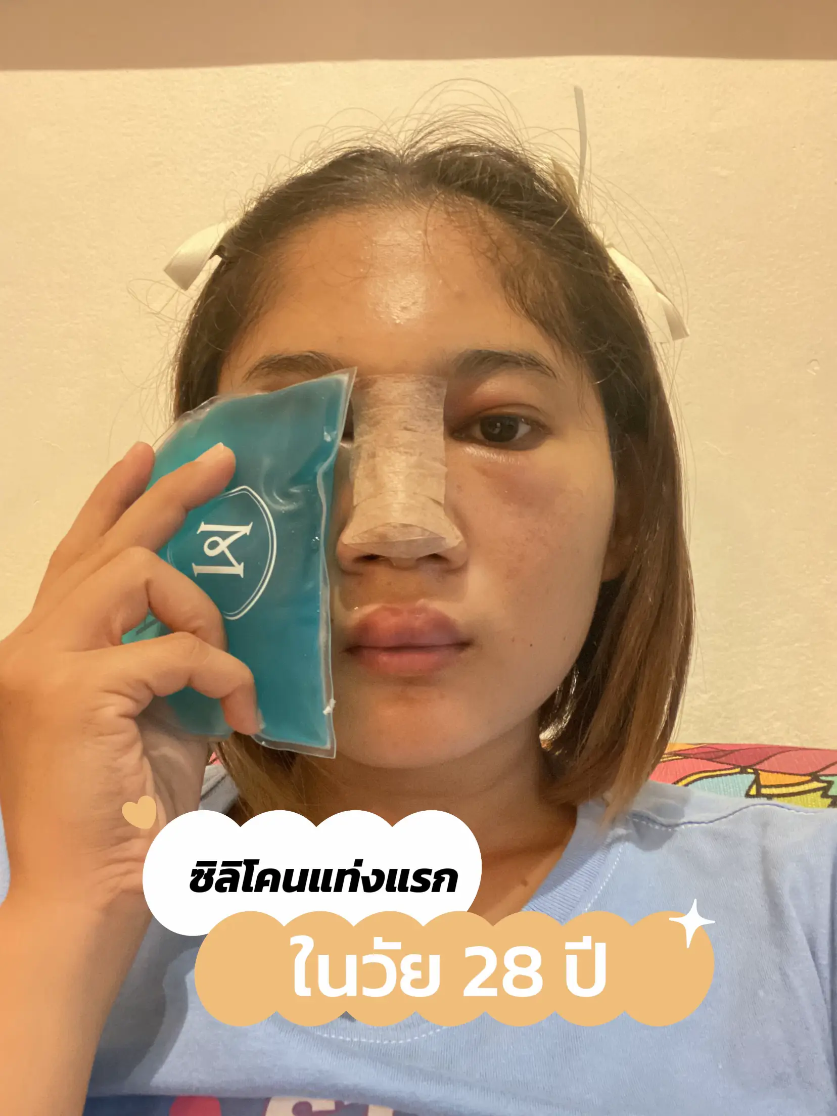 เสริมจมูกในวัย 28 ปี | แกลเลอรีที่โพสต์โดย Yippee Klean | Lemon8