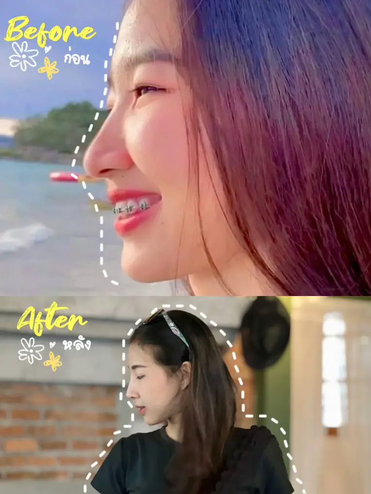 รีวิวศัลยกรรมครั้งแรก ฉบับคนเนื้อน้อย | แกลเลอรีที่โพสต์โดย Popla 🐳 | Lemon8