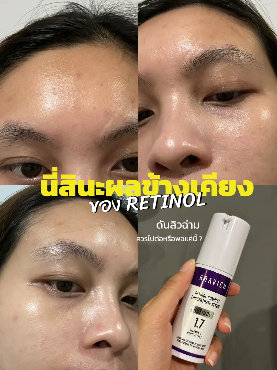 Chapter.5 เจ้าสาวใช้ RETINOL แต่มันดันสิว !! | แกลเลอรีที่โพสต์โดย Bemi ...