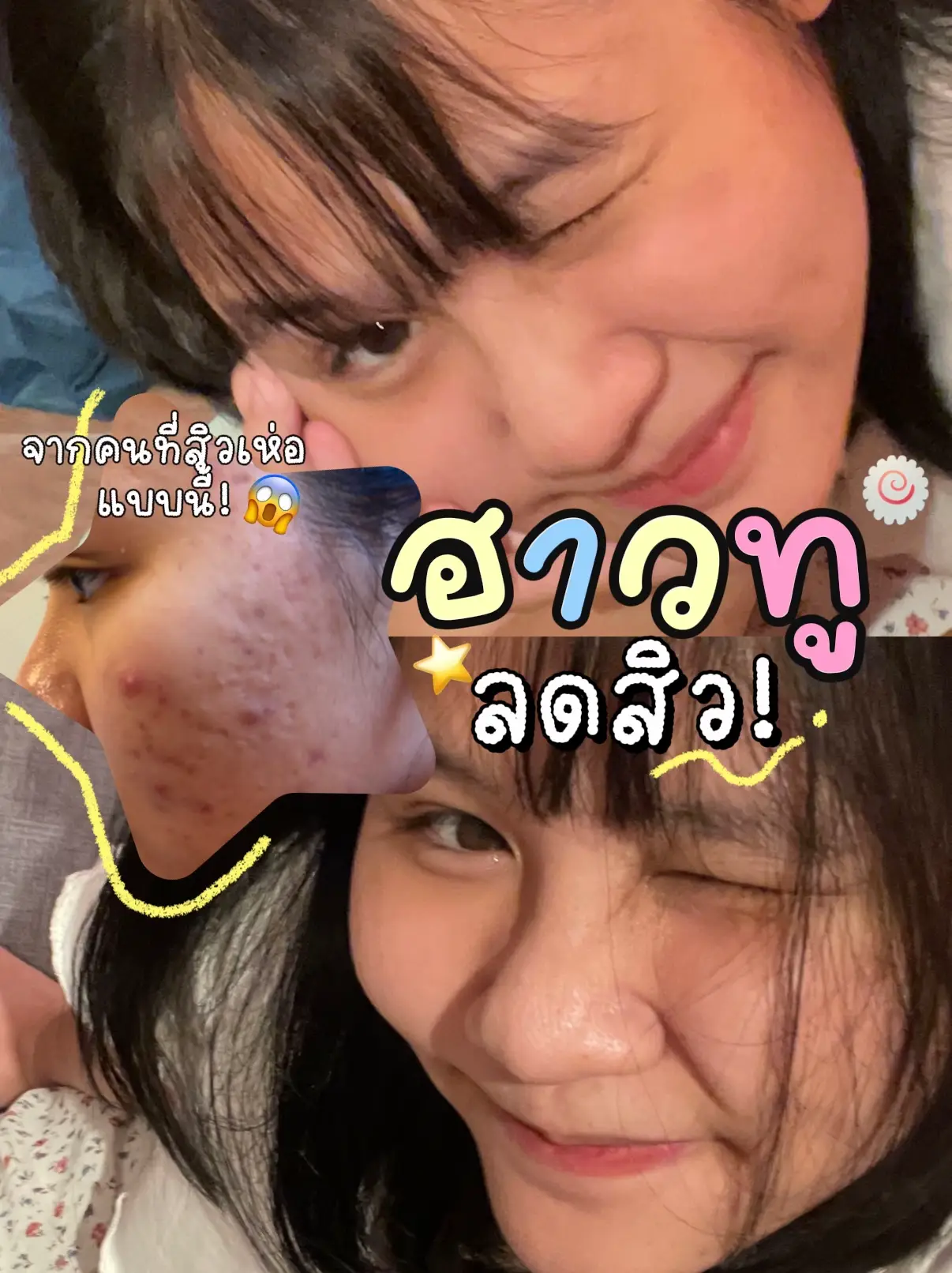 Ep.1 กู้สิวเห่อ ภายใน7วัน! (No Spon) | แกลเลอรีที่โพสต์โดย ffernfk | Lemon8