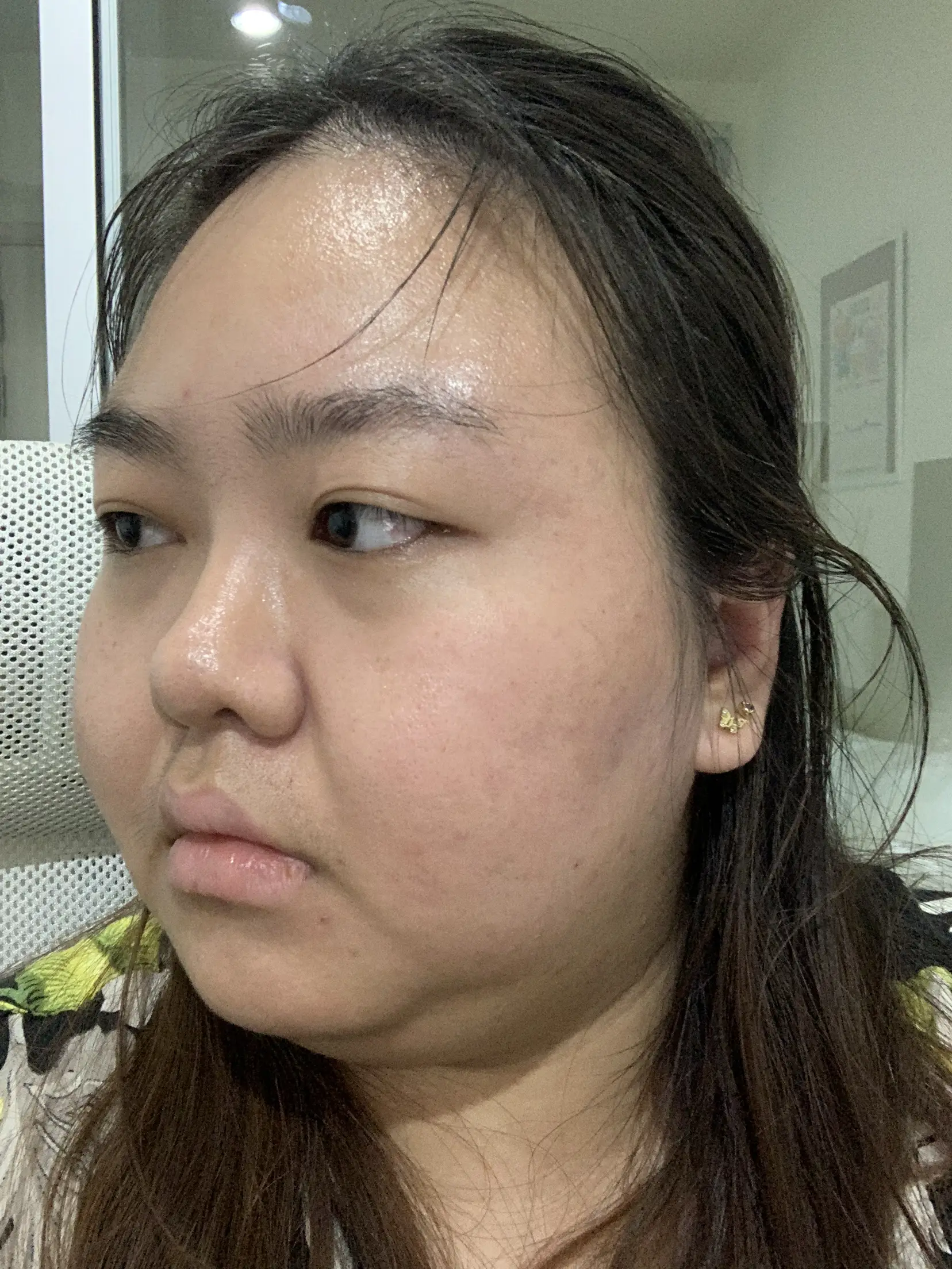 รีวิวรักษาสิวที่พรเกษมคลินิก จากหน้าสิวมาทั้งชีวิต สู่หน้าใสที่ใฝ่ฝัน