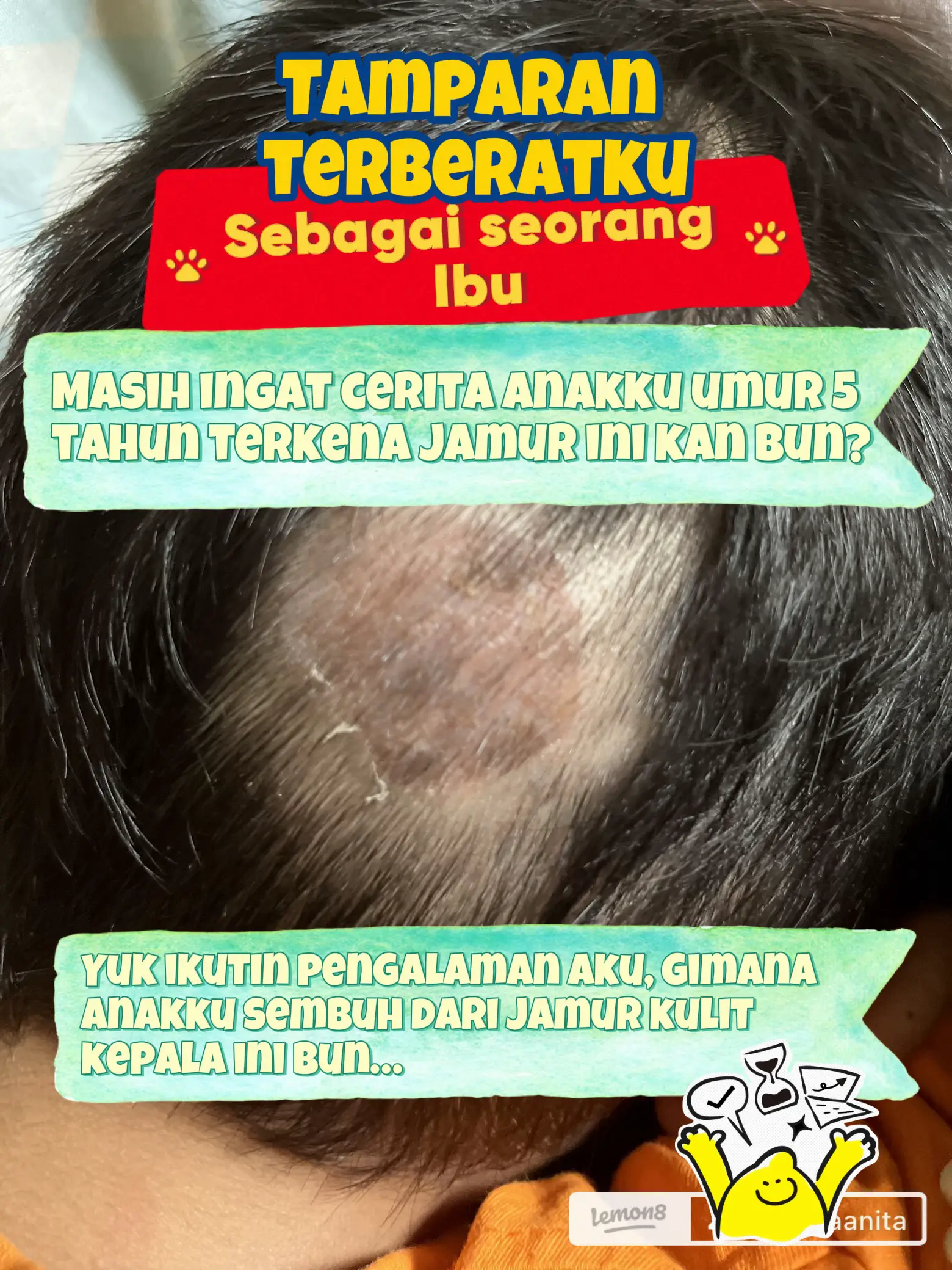 Tinea Capitis Koreng Kulit Kepala akibat Jamur | Galeri diposting oleh ...