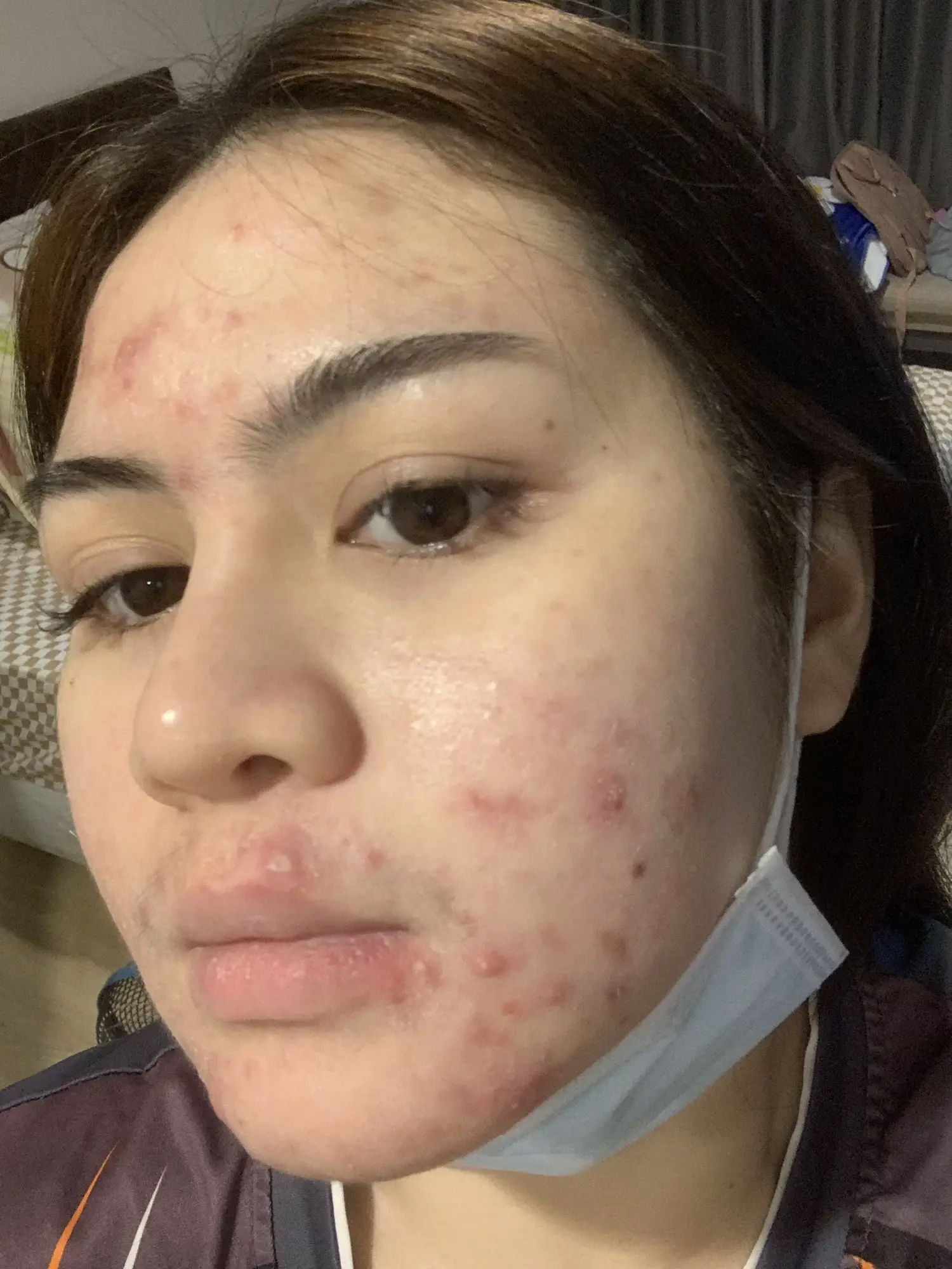 รักษายังไงดีแนะนำหน่อยค่ะ เครี | แกลเลอรีที่โพสต์โดย Pemika | Lemon8