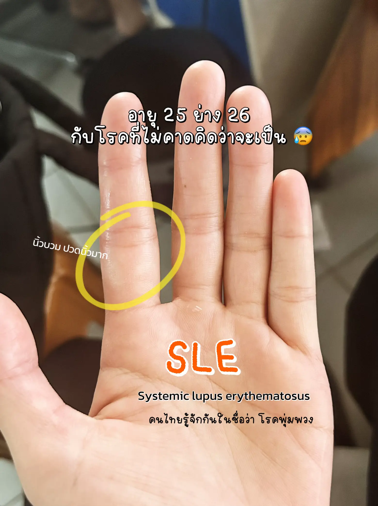 19 ไอเดียยอดนิยมเกี่ยวกับ ลดบวม Proctase P คือ ยา แก้ อะไร ในปี 2025