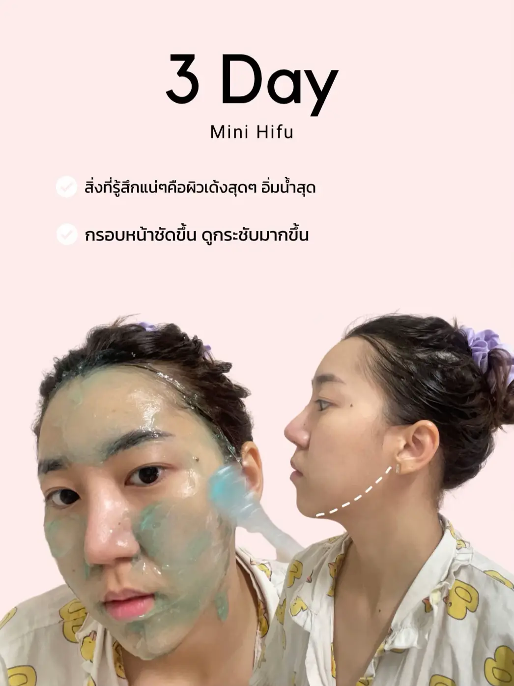 รีวิว ทำMini Hifu 5 วัน ปัง หรือ พัง!!! | แกลเลอรีที่โพสต์โดย Meny ...