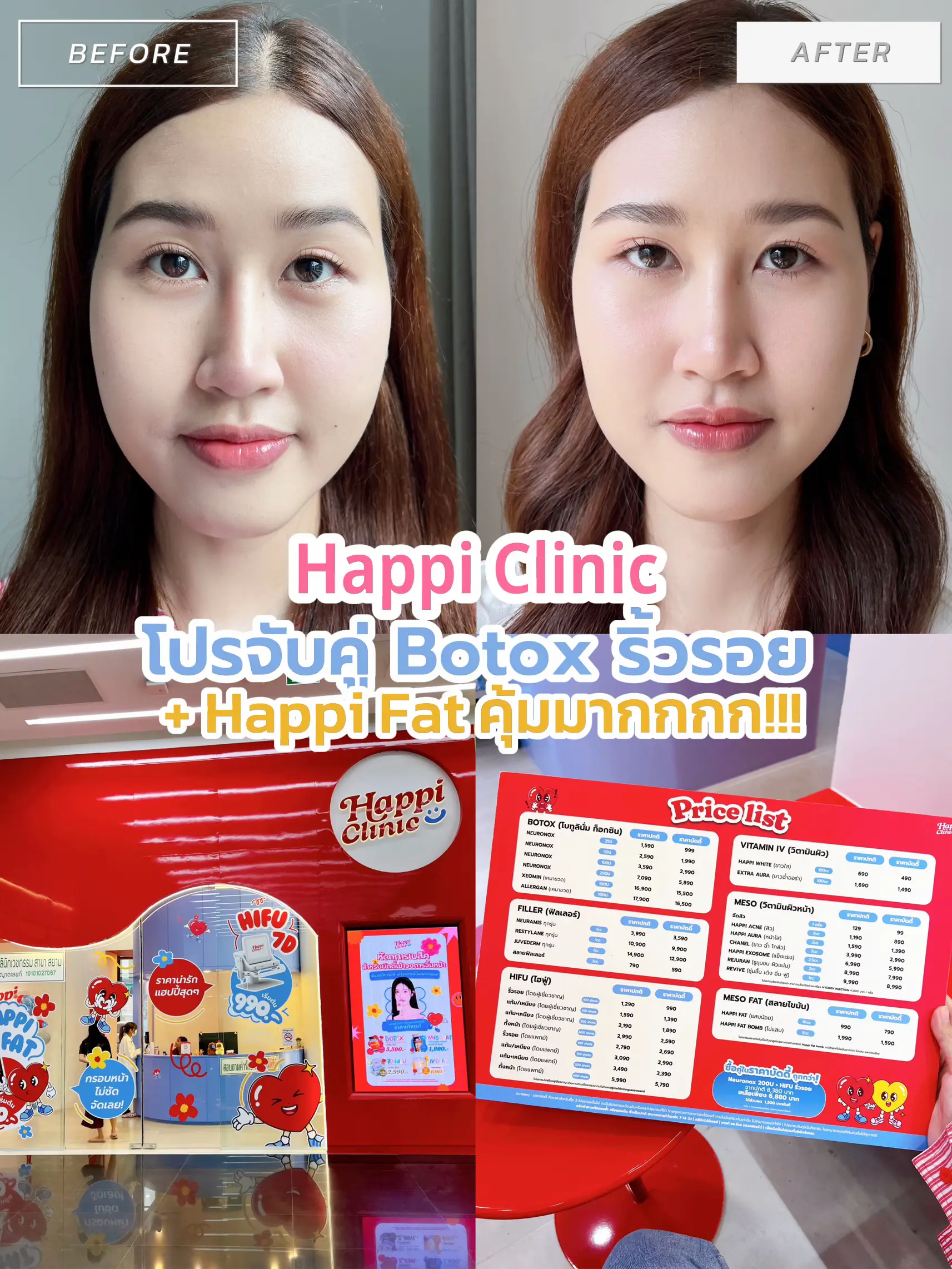อัปเดทหัตถการในรอบ 8 เดือน💉 กับโปรจับคู่ที่ Happi Clinic ️ | แกลเลอรี ...