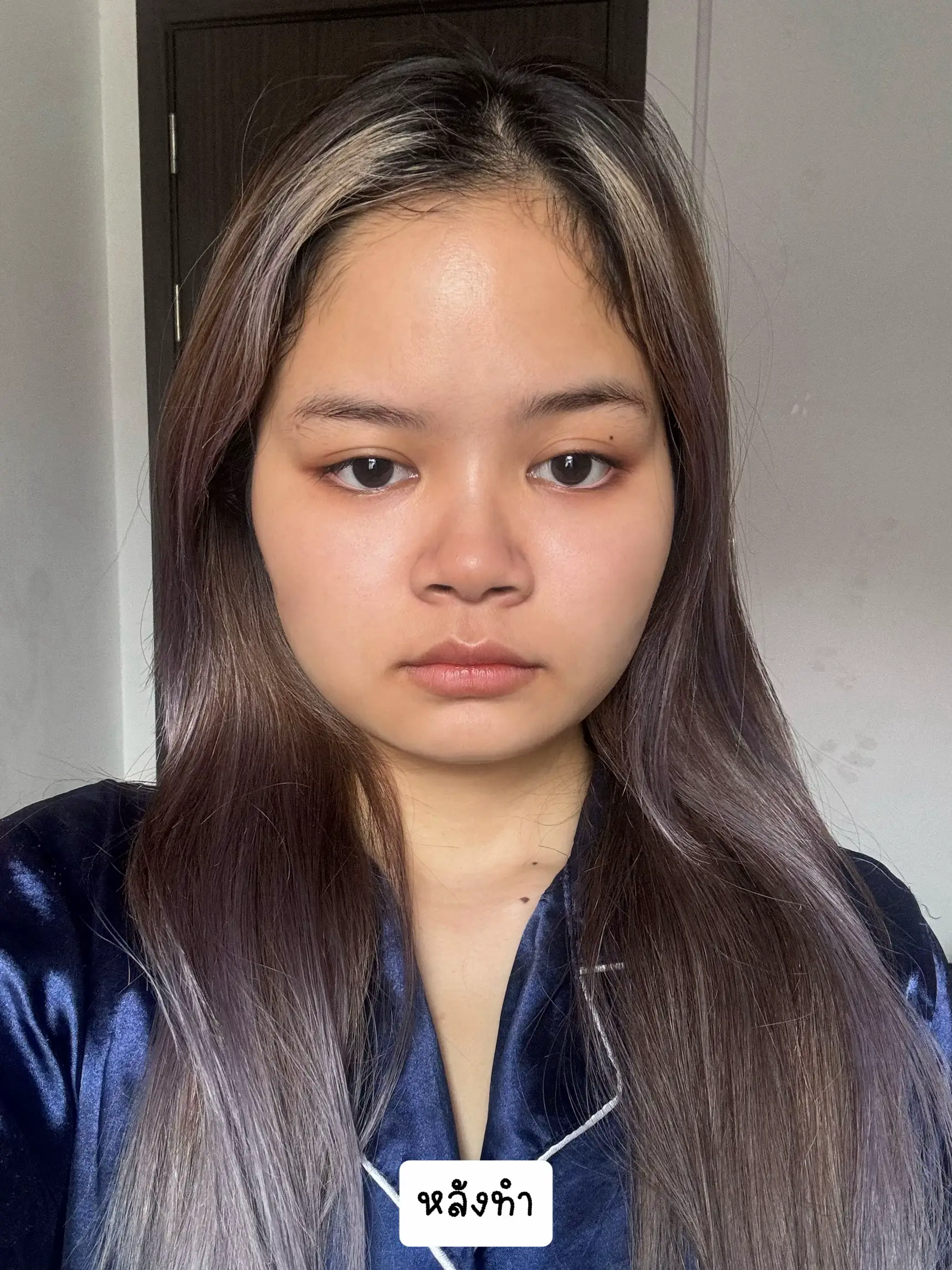 แชร์ประสบการณ์การทำ Pico Laser | แกลเลอรีที่โพสต์โดย JaJah | Lemon8