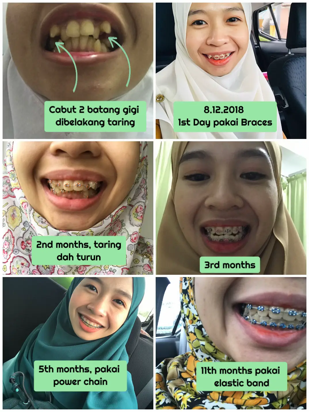My Journey Getting Braces [ Cost & Process] | Galeri disiarkan oleh ...