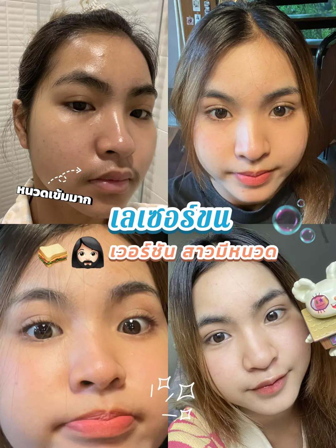 เลเซอร์ขน เวอร์ชั่นสาวมีหนวดดด🧔‍♀️ ️ | แกลเลอรีที่โพสต์โดย Berbbu.beb | Lemon8