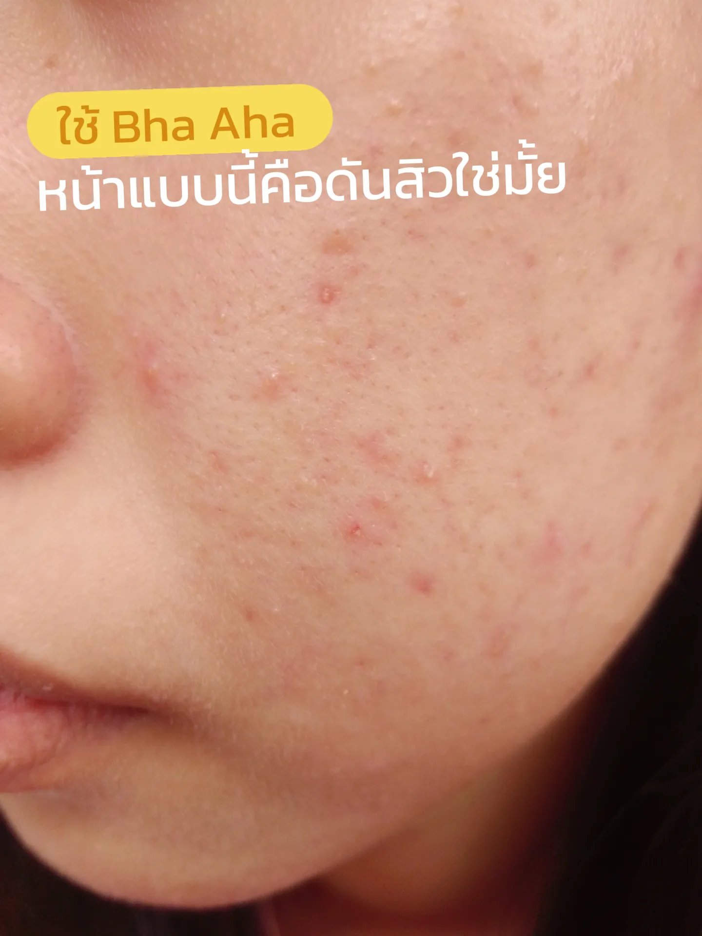 เริ่มใช้bha ahaมาสัปดาห์นึงแล้วค่ะ | แกลเลอรีที่โพสต์โดย ขอหน้าใสไร้สิว ...