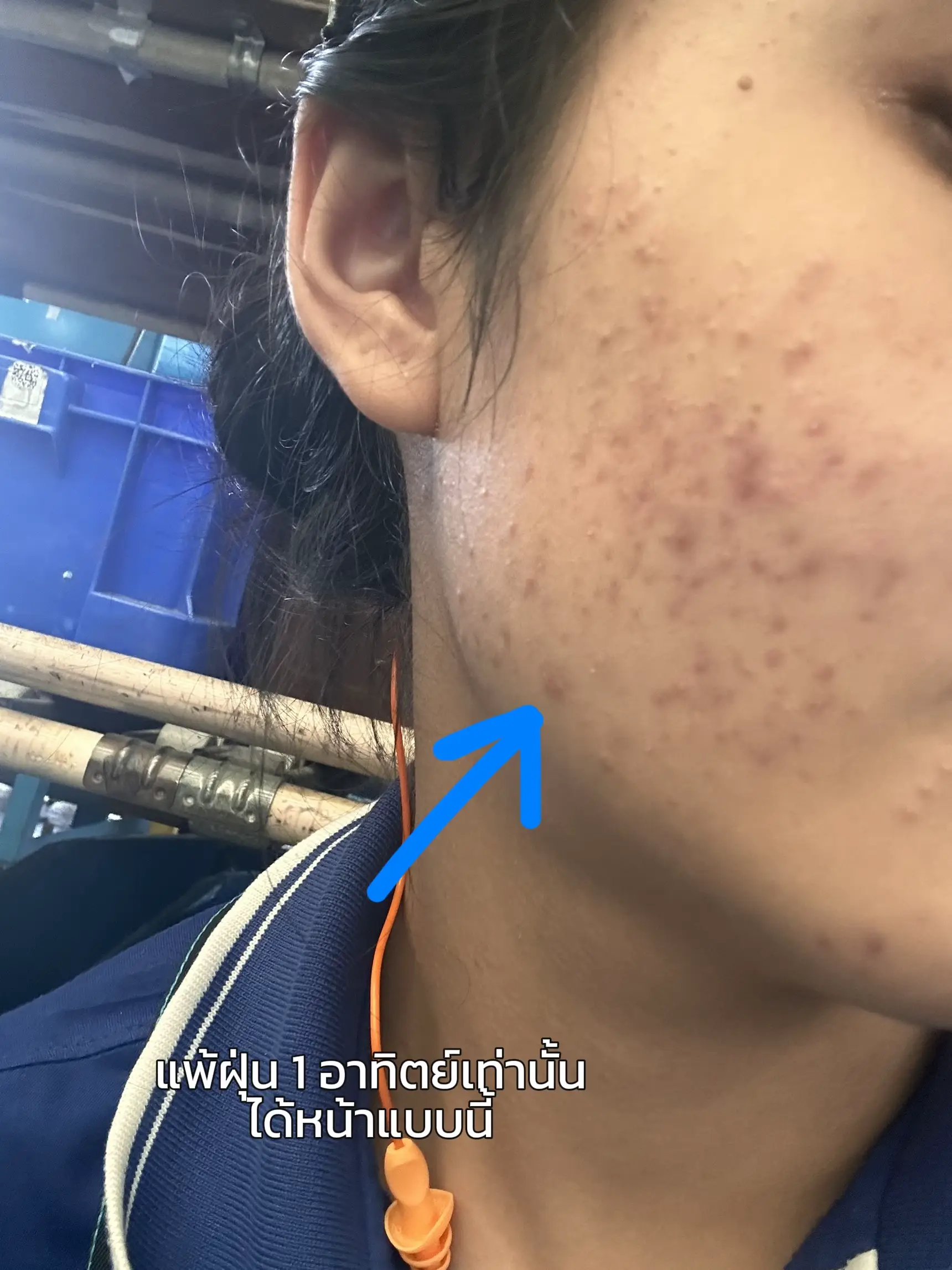 Ep.1 กู้สิวเห่อ ภายใน7วัน! (No Spon) | แกลเลอรีที่โพสต์โดย ffernfk | Lemon8