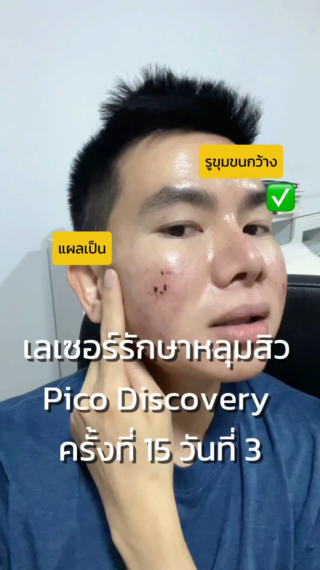ประสบการณ์เลเซอรรักษาหลุมสิว ครั้งที่ 15 วันที่ 3 Pico Laser | วิดีโอที่เผยแพร่โดย Happy Nucha ...
