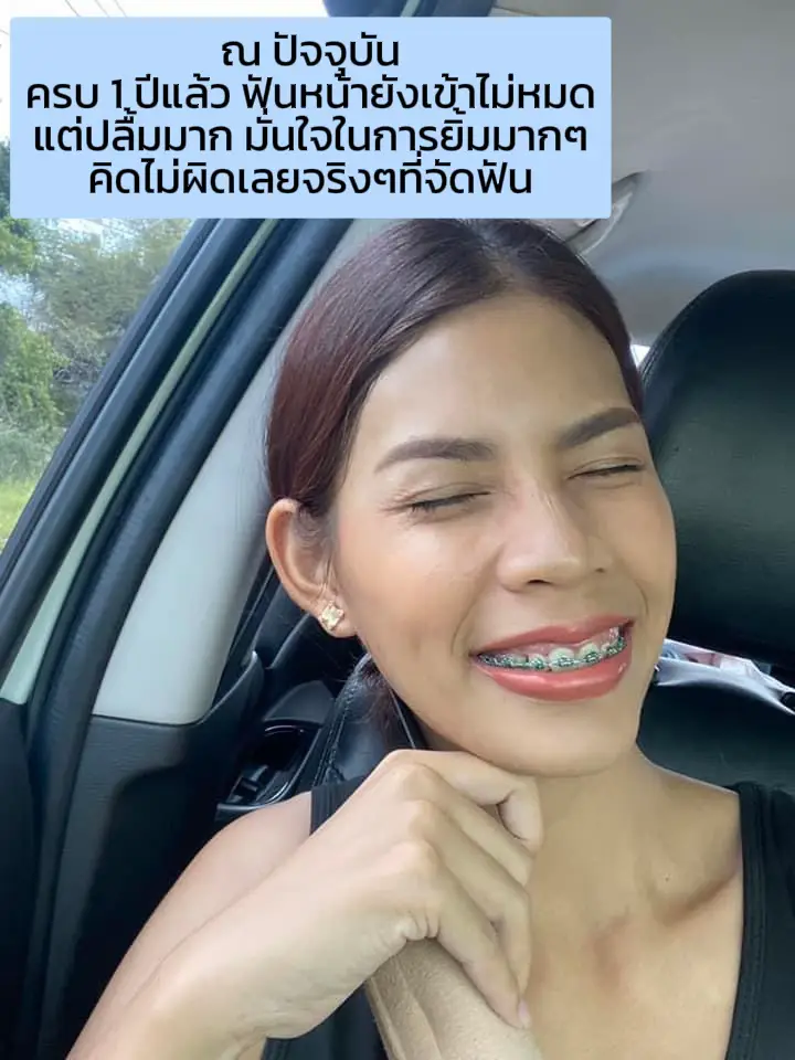 จัดฟันครบ 1 ปีแล้ว มีอะไรเปลี่ยนไปบ้าง? | แกลเลอรีที่โพสต์โดย Ratchaporn Sinm | Lemon8