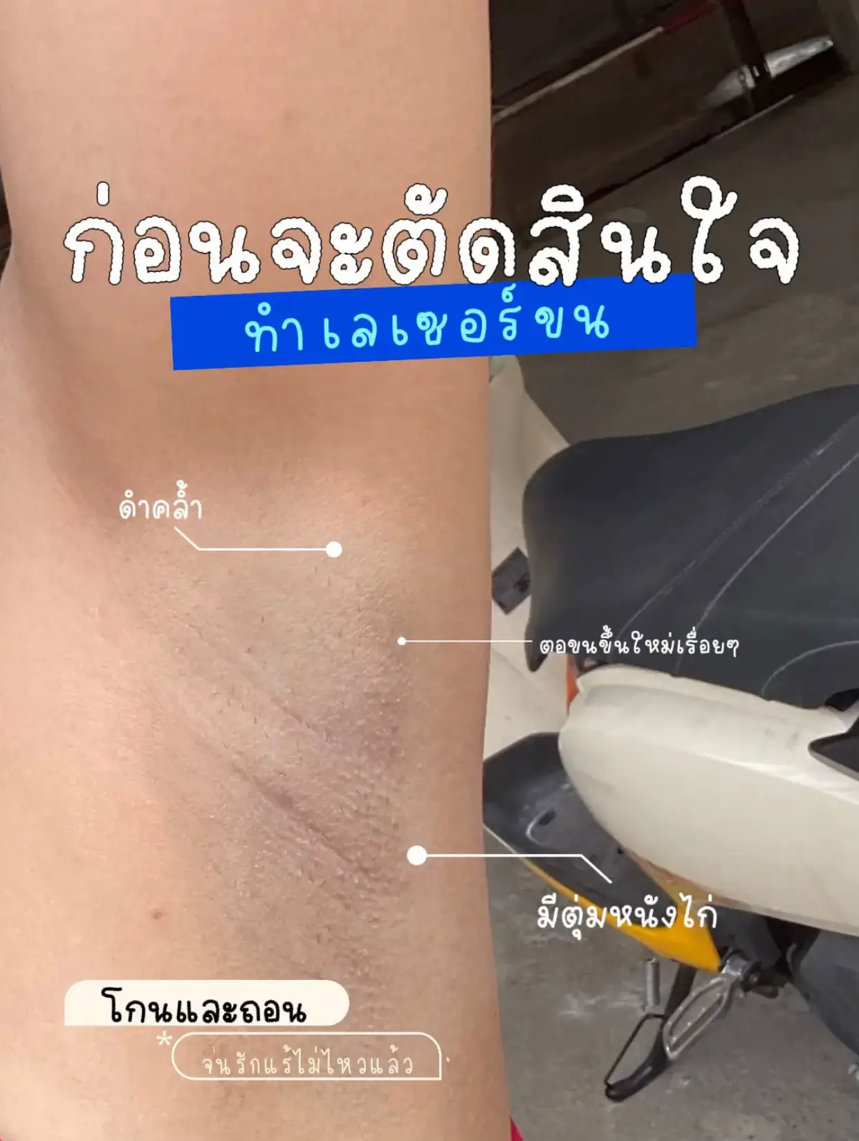 แชร์ประสบการณ์เลเซอร์ขนรักแร้ครั้งแรก🍋 💖 | แกลเลอรีที่โพสต์โดย Buachompoo | Lemon8