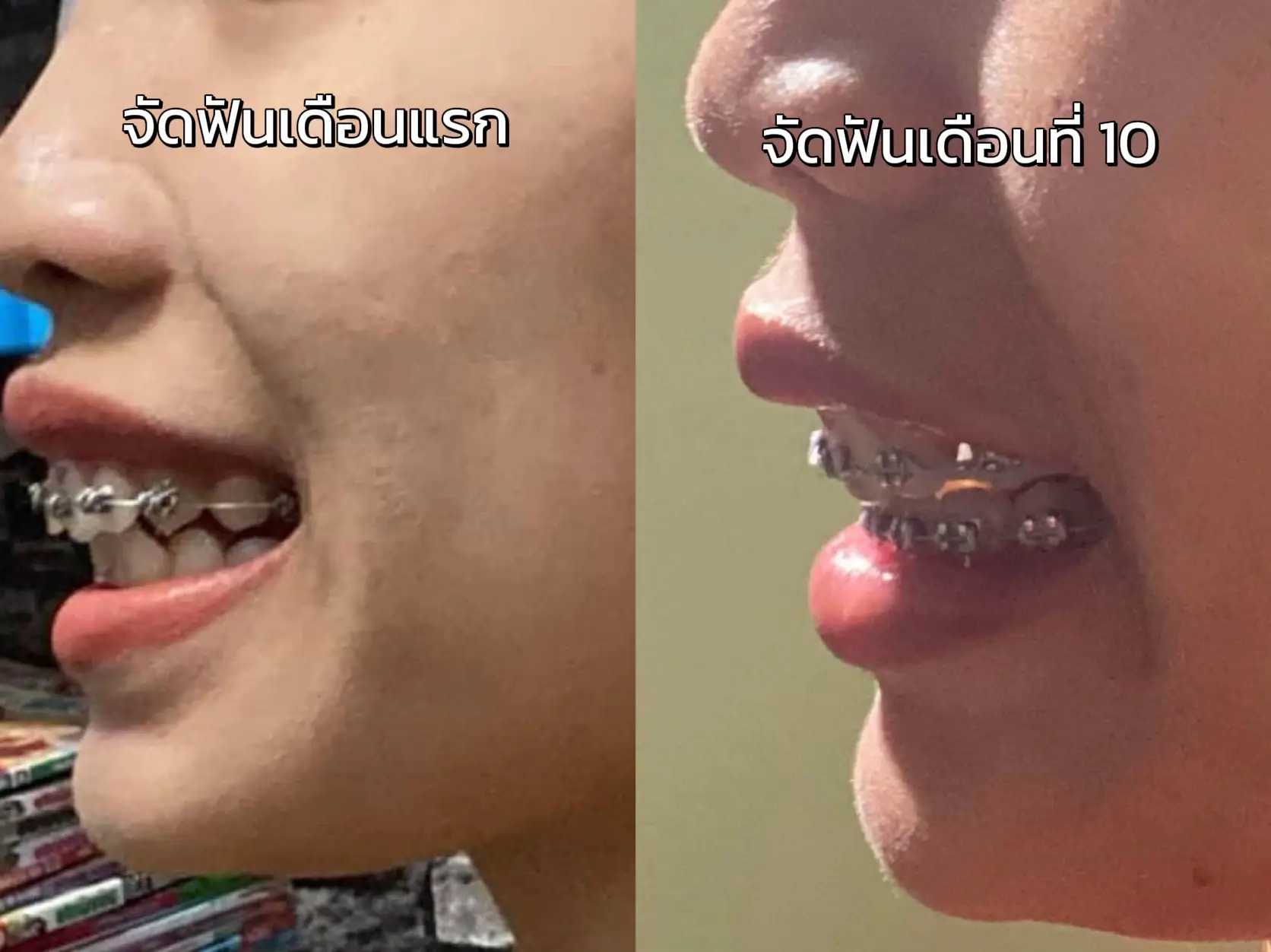 จัดฟันครบ 1 ปีแล้ว มีอะไรเปลี่ยนไปบ้าง? | แกลเลอรีที่โพสต์โดย Ratchaporn Sinm | Lemon8