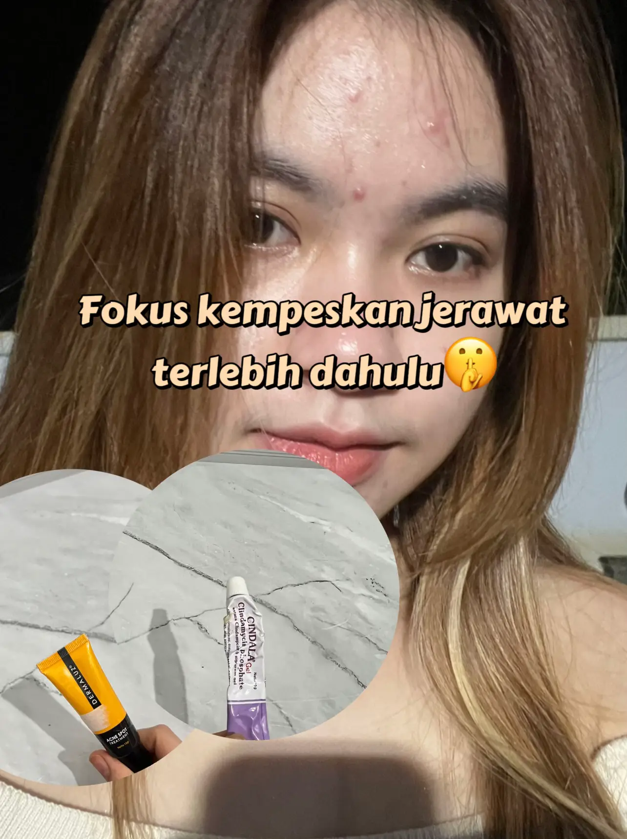 HEMPAS JERAWAT DAN BEKASNYA! SKINCARE AJA GACUKUP😫 | แกลเลอรีที่โพสต์โดย 🦄🦋anggi | Lemon8