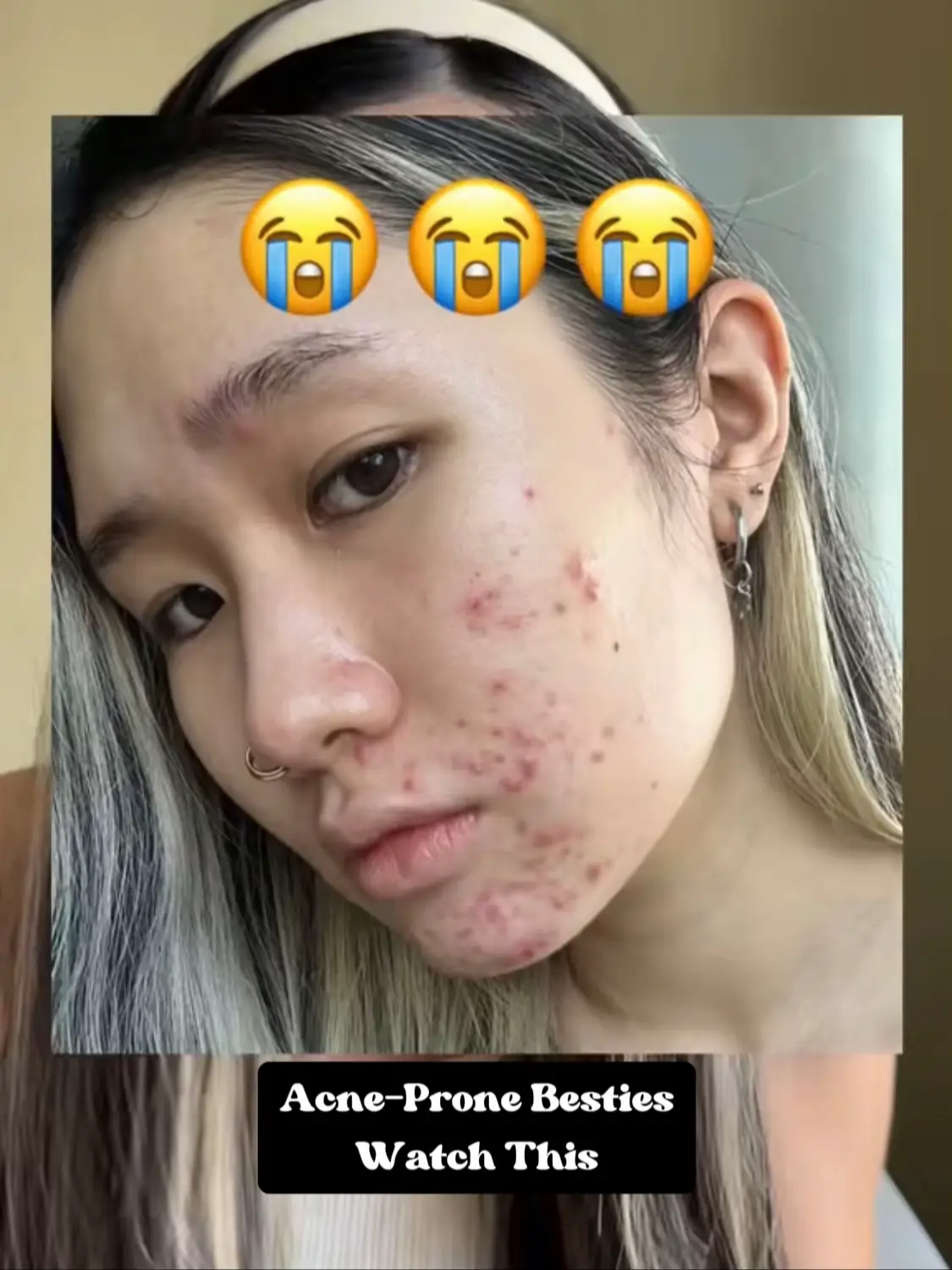 This Toner and Acne-Prone Skin are Besties | Video diterbitkan oleh RNW Care MY | Lemon8