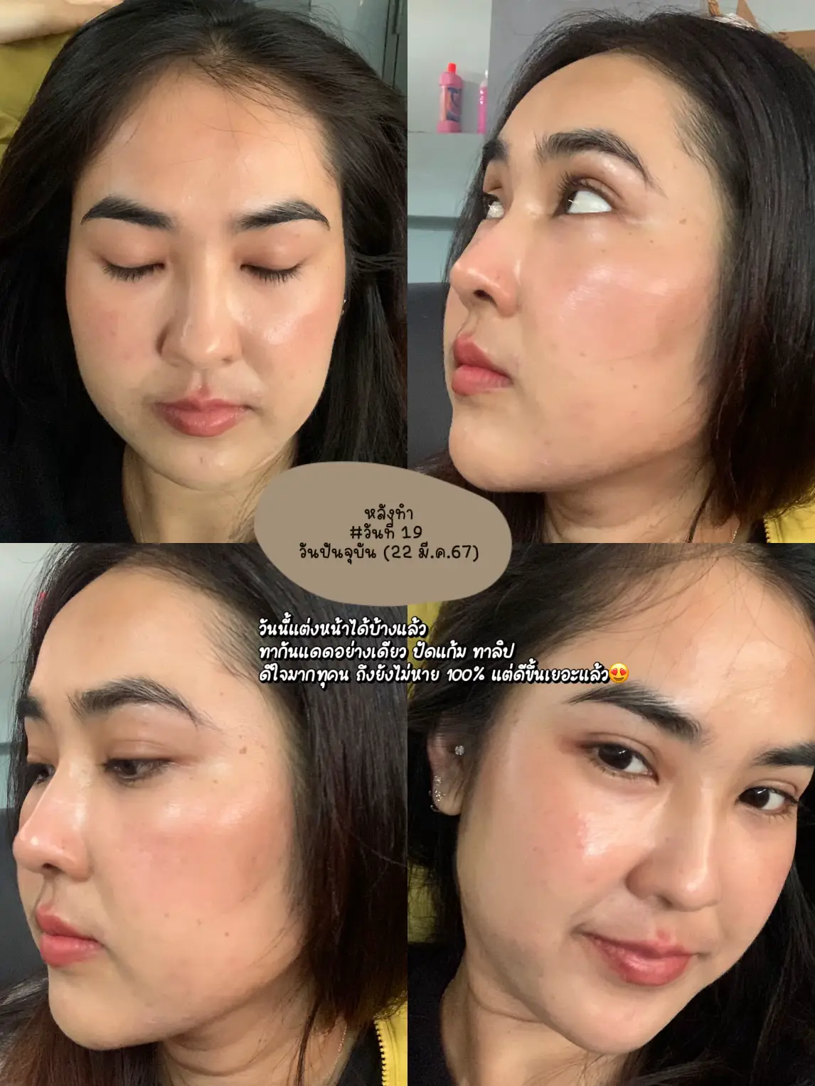 ทำ Pico laser ดีจริงมั้ย? ️ | แกลเลอรีที่โพสต์โดย ℕ𝕀𝕋𝔸｡ ¨̮ | Lemon8