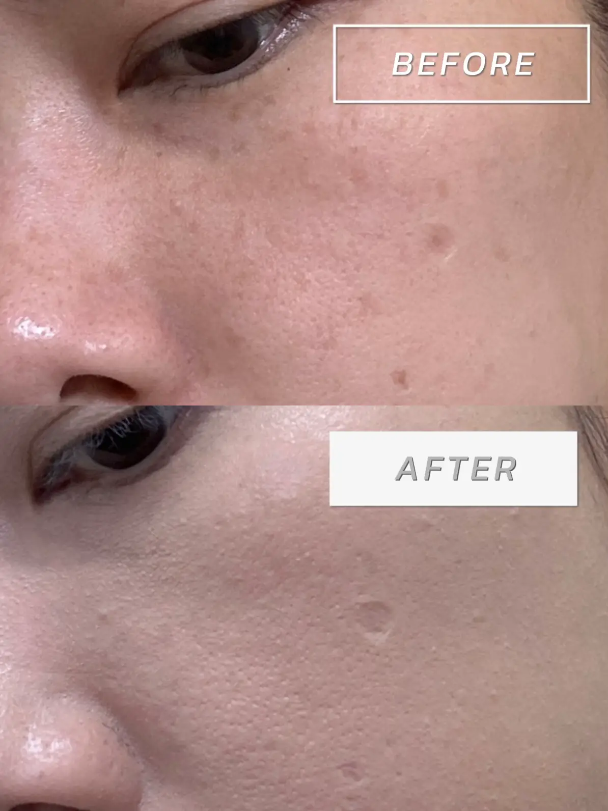 Dr. PONG ACNE ACE LONG WEAR CUSHION | แกลเลอรีที่โพสต์โดย JaniezPN | Lemon8