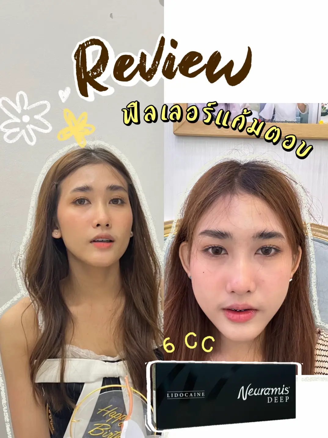 Review ฟิลเลอร์แก้มตอบ 6 CC | แกลเลอรีที่โพสต์โดย Ja.kim | Lemon8